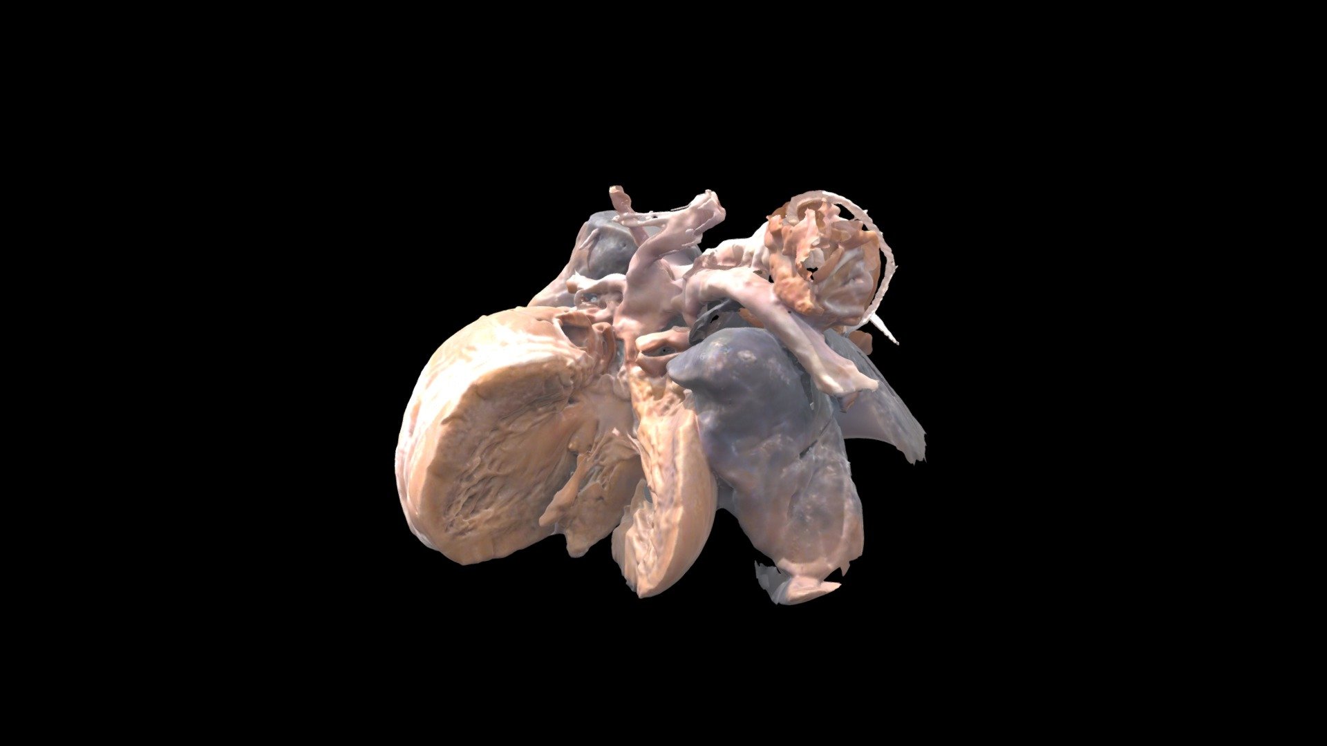 Coarctation with small left heart structures - 3D model by Rohit Loomba ...