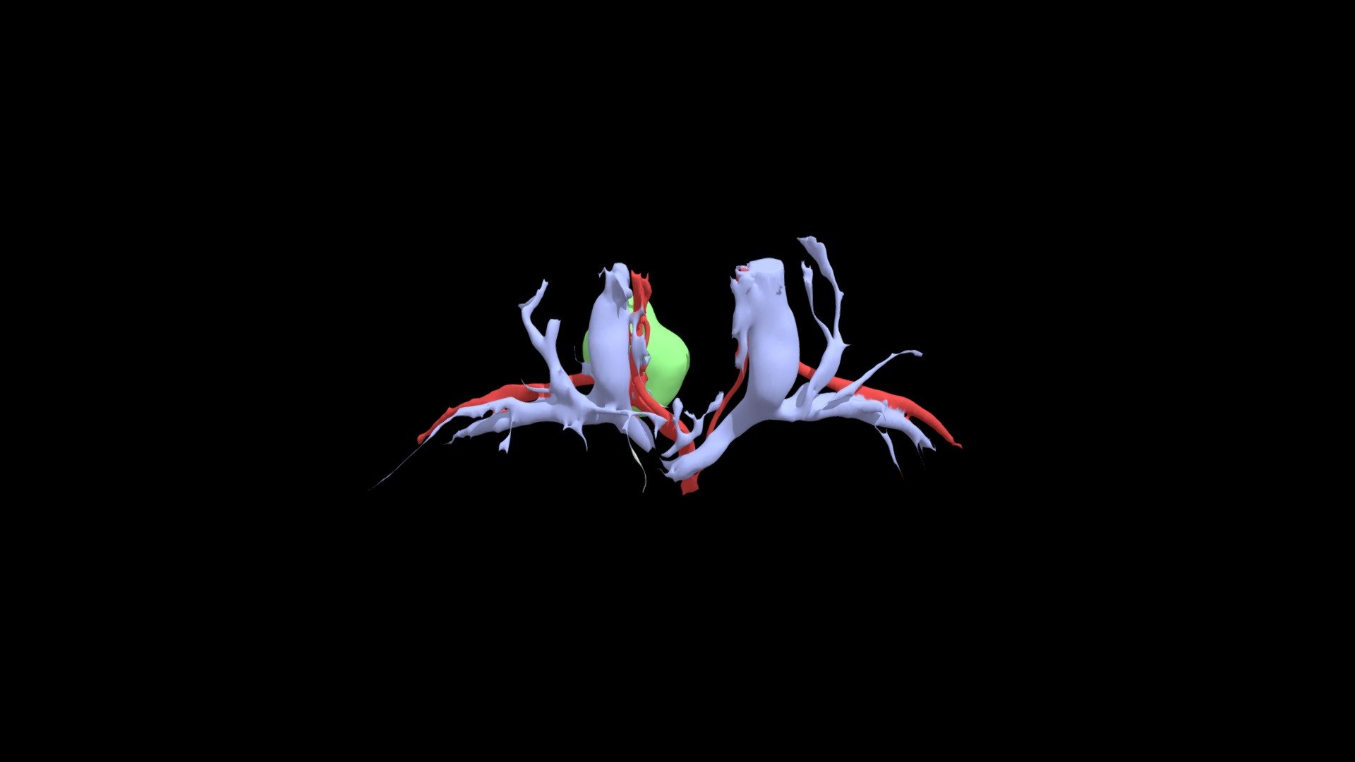 Mediastinal tumor from poor quality MRI - Download Free 3D model by ...