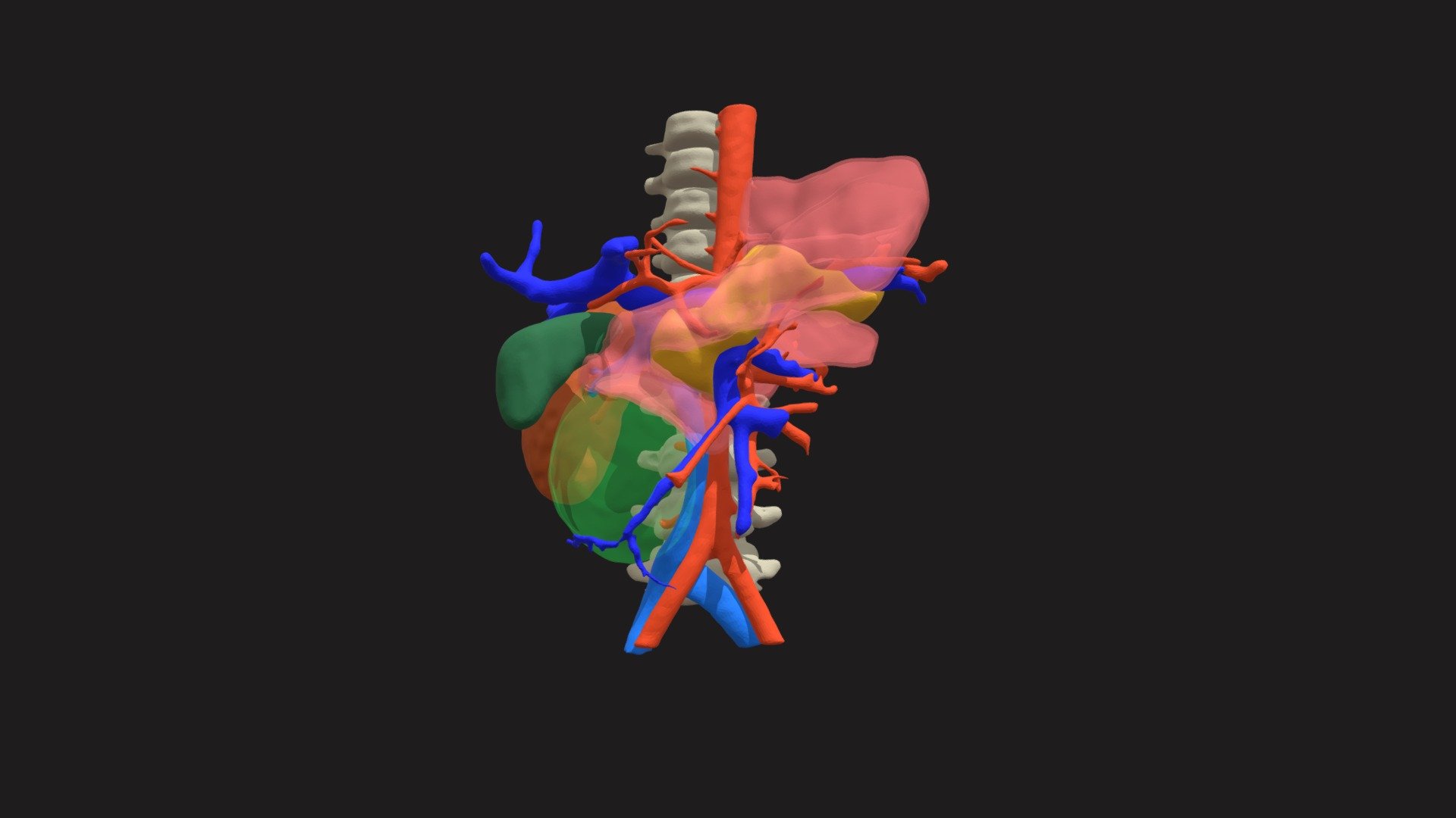 Tumor in retroperitoneum near the duodenum - 3D model by thorac ...