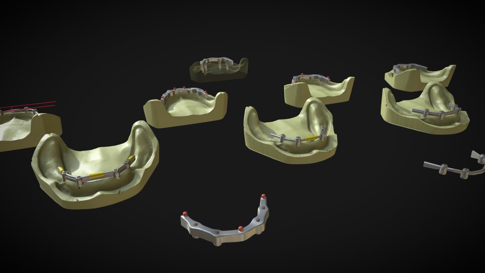 Mandibular Overdenture IOD-4 - 3D model by Muhammad Nabeel ...