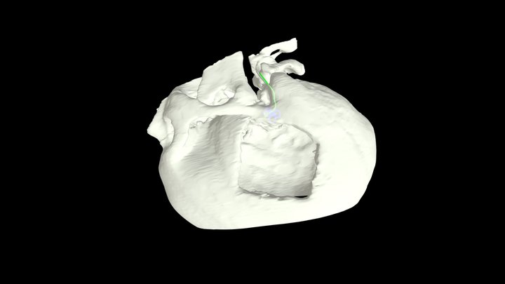 Posterior-fossa 3D models - Sketchfab