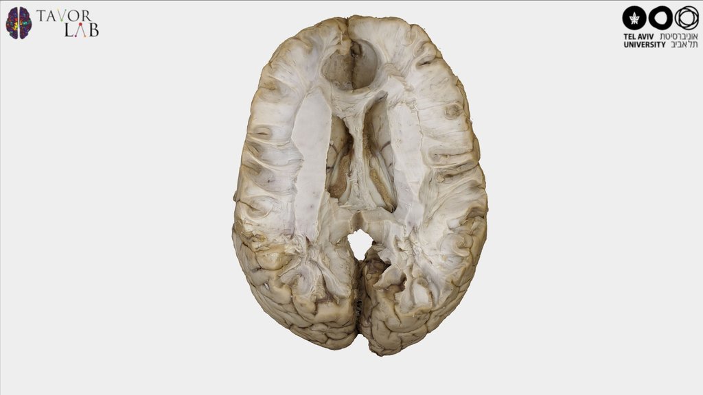 Brain ventricles - A 3D model collection by aherrler - Sketchfab