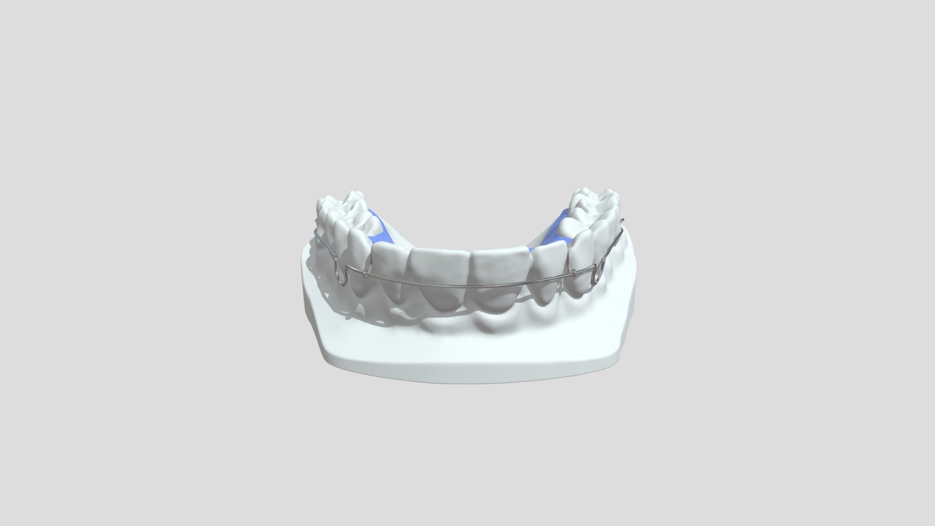 Wraparound With Support Wires - 3D model by ODL OrthoLab (@Odlortho ...