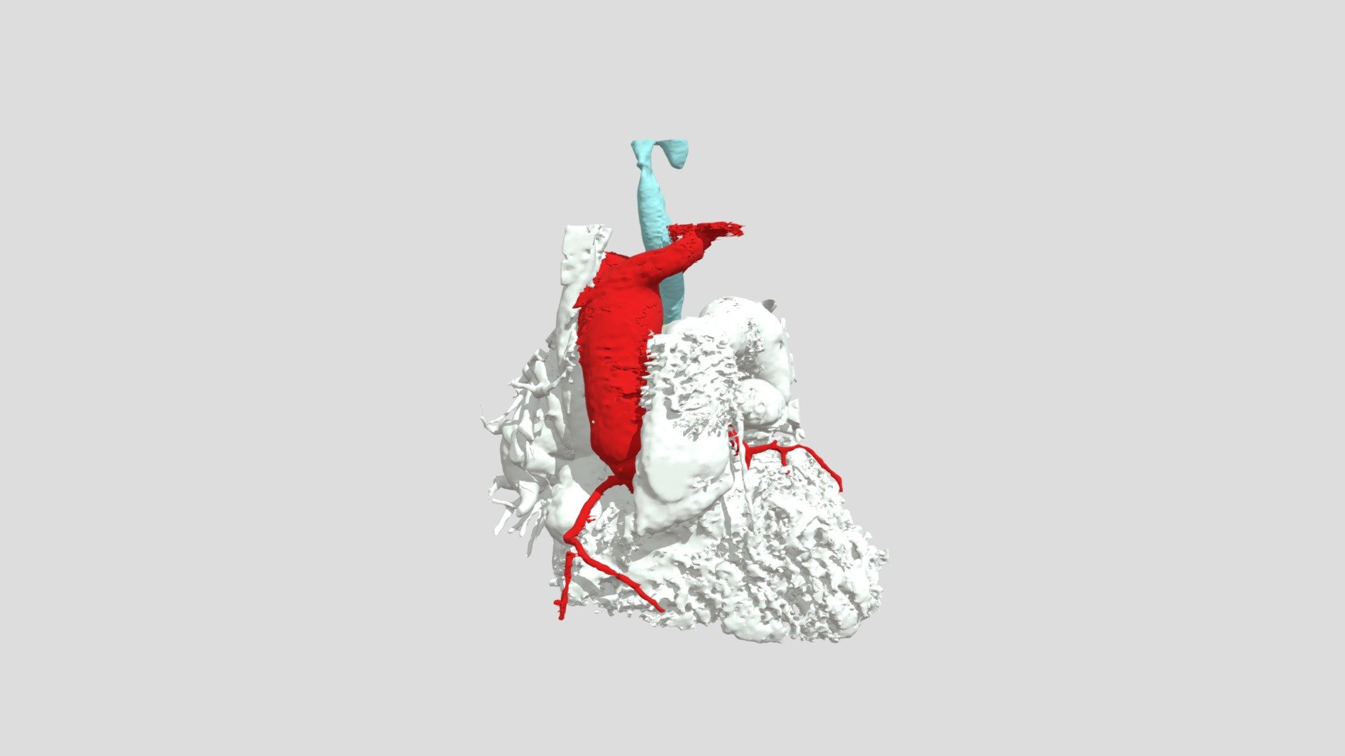Sinus Venosus ASD, PAPVR, LSVC (S0332) - 3D model by NCHS Cardiac ...