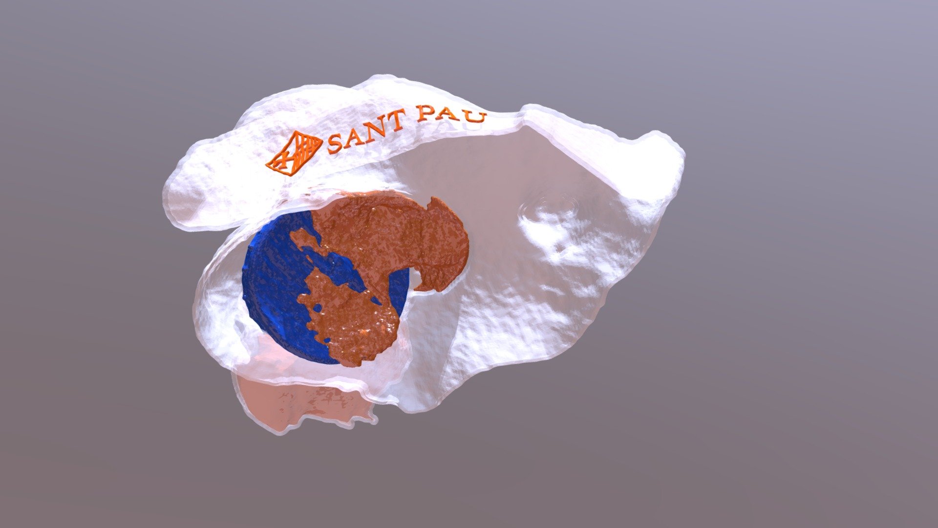Left atrial appendage closure with thrombus - 3D model by Abdel Hakim ...