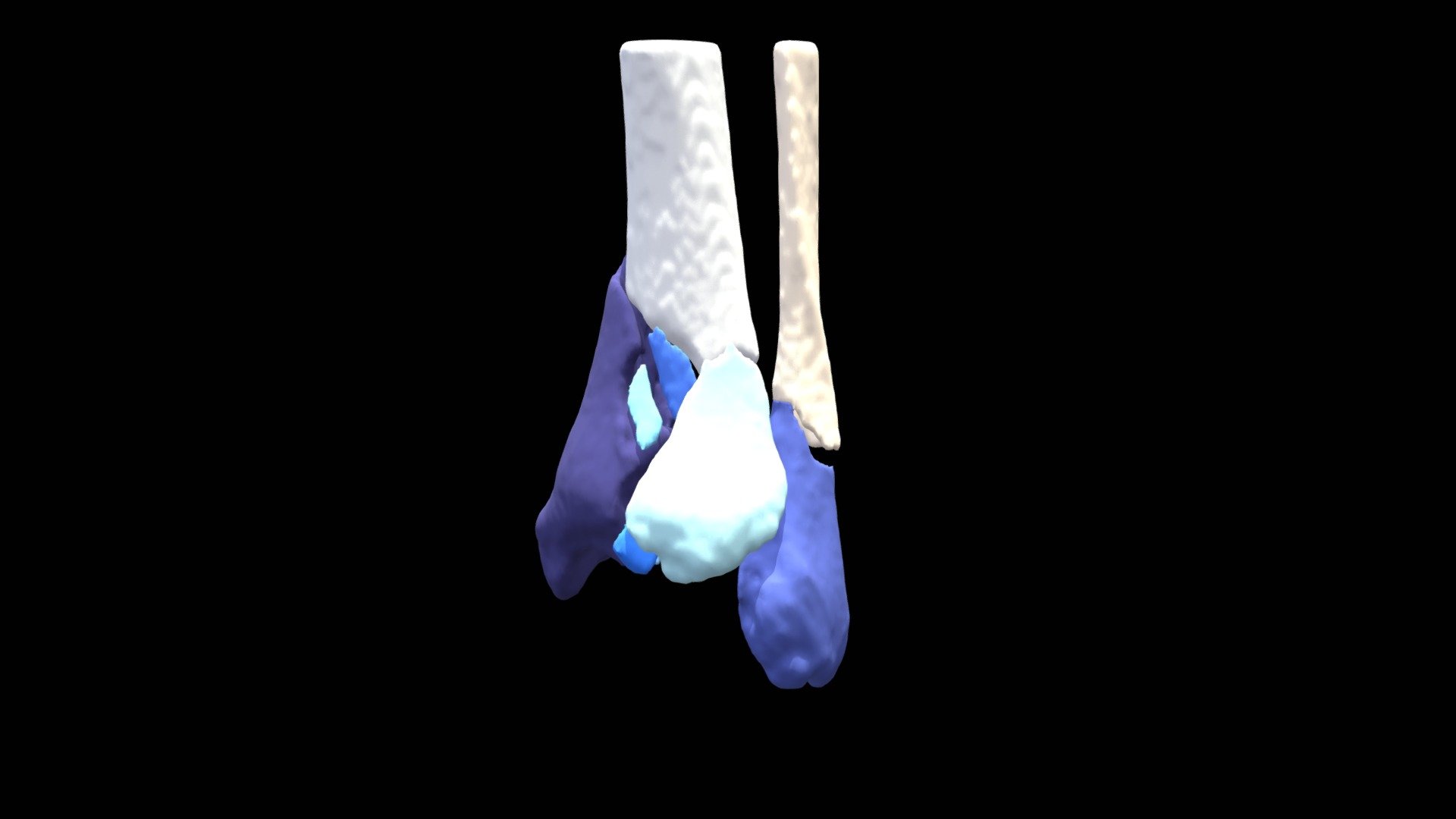 Session 4.01 | Pilon Fracture - MIPO vs ORIF|BOS - Download Free 3D ...