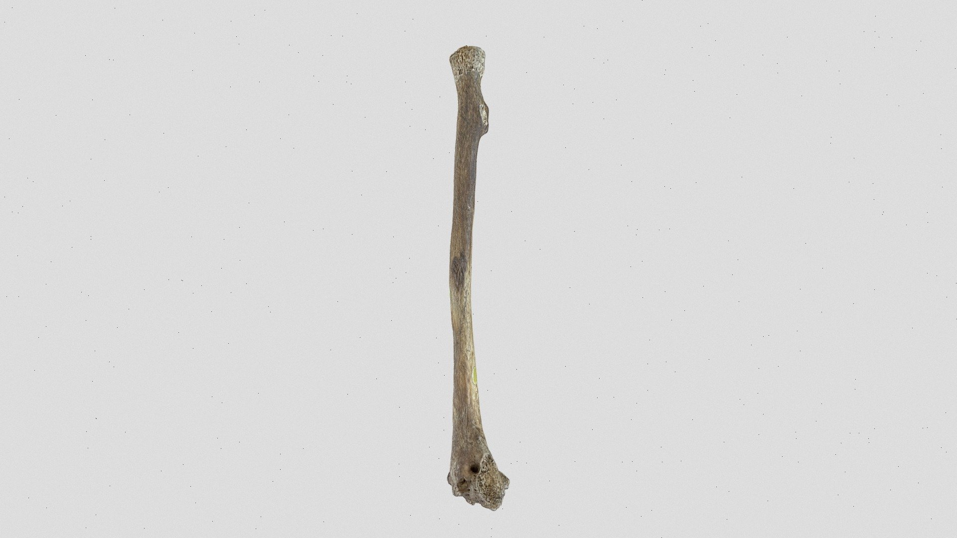 Smith's fracture of distal radius - 3D model by BIoArchaeology at UCL ...