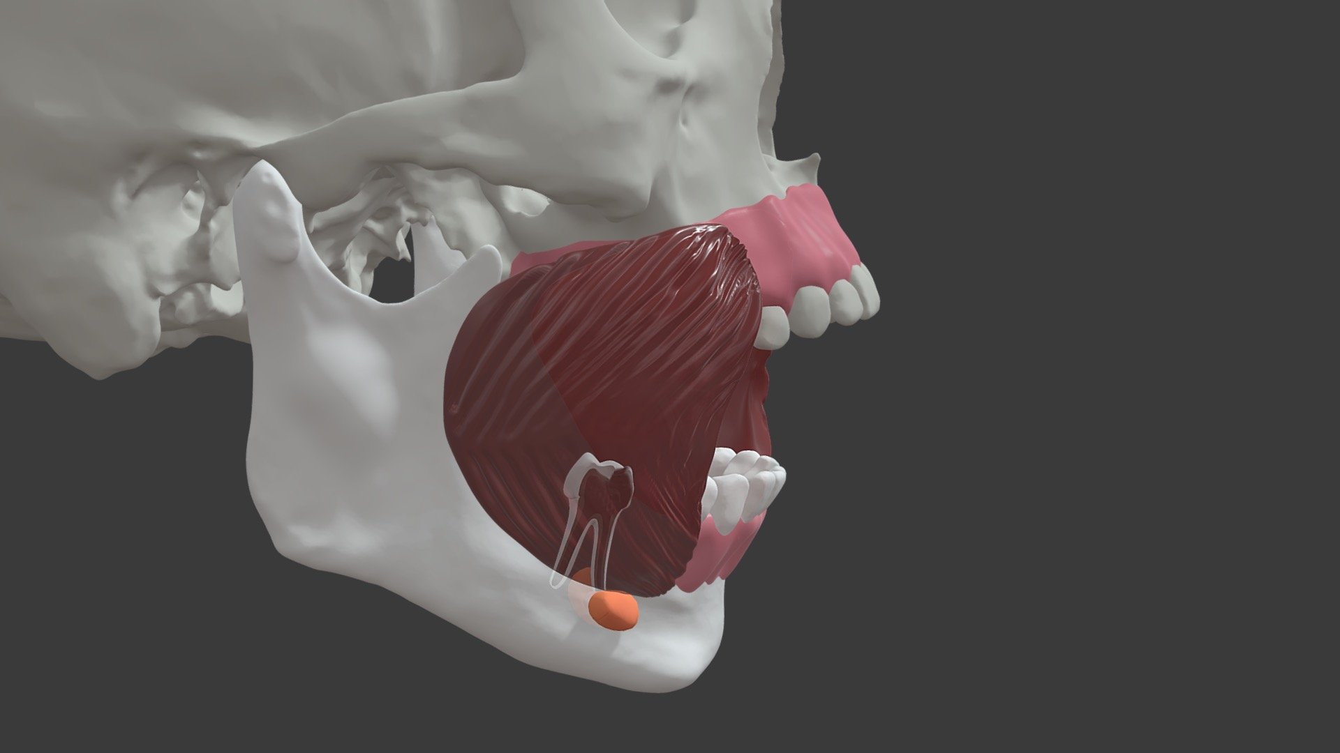 Stage 4 Mandibular Molar Infection Pathway-2 - 3D model by University ...