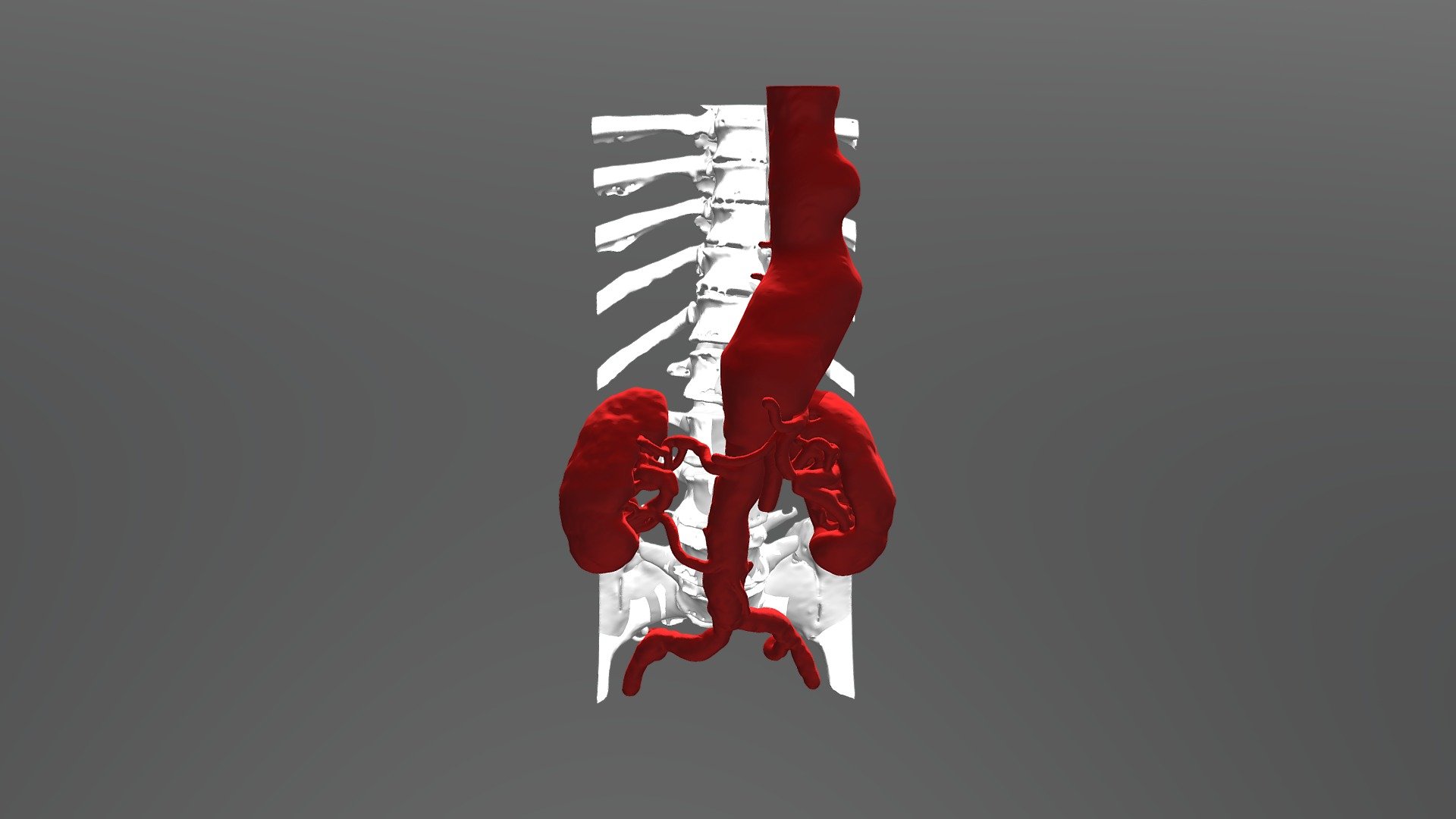 Thoracoabdominal aortic aneurysm TAAA - 3D model by valchanov [40a141b ...