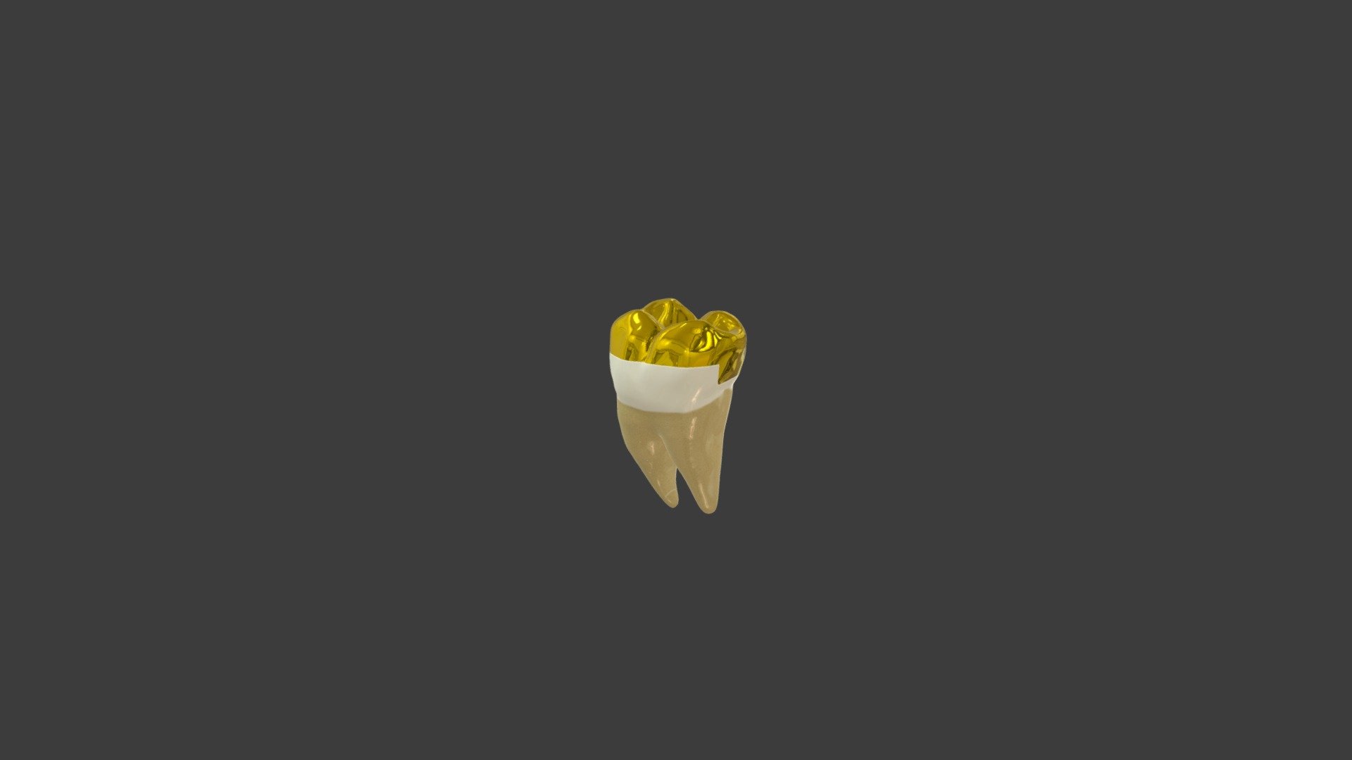 Gold Onlay - 3D model by Ahmed Mahrous (@drahedmahrous) [40a58e3 ...