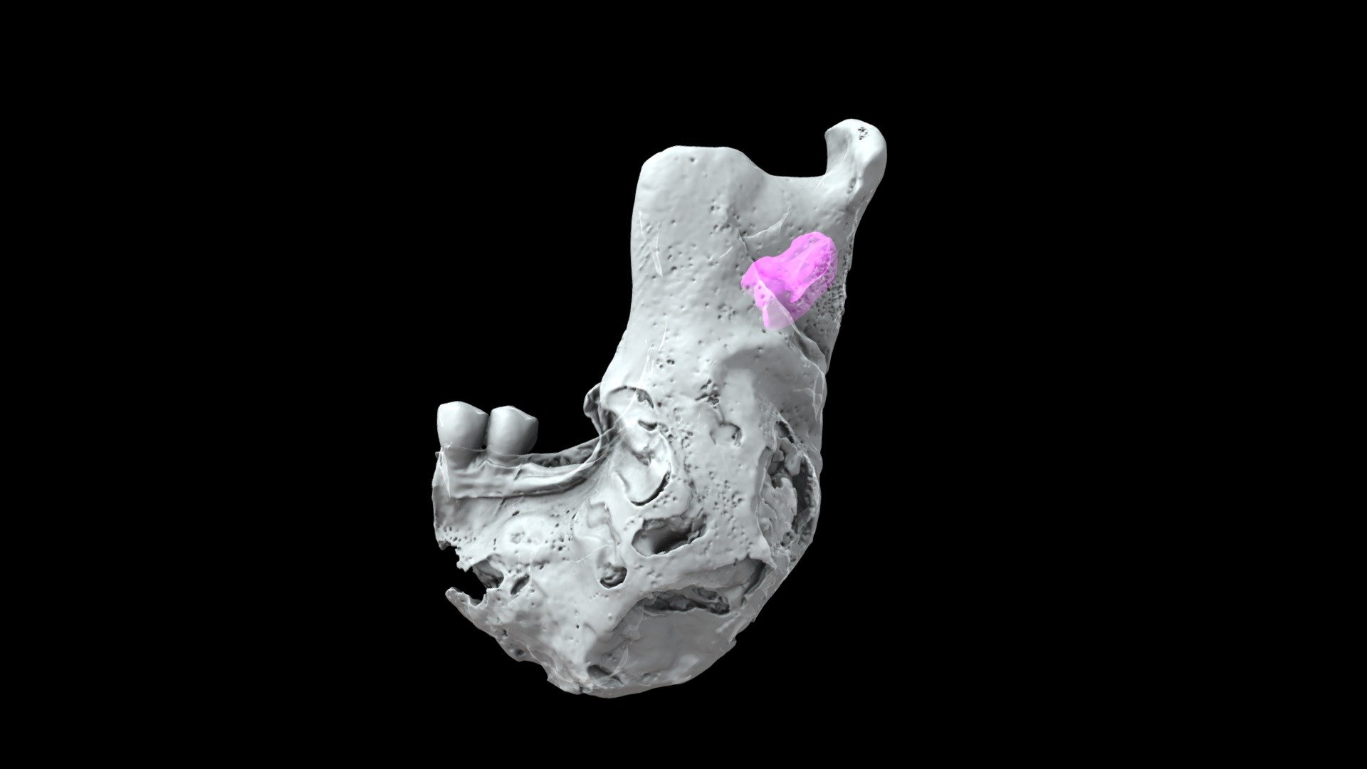Mandible with pathology (VCU_3D_7617) - 3D model by Virtual Curation ...