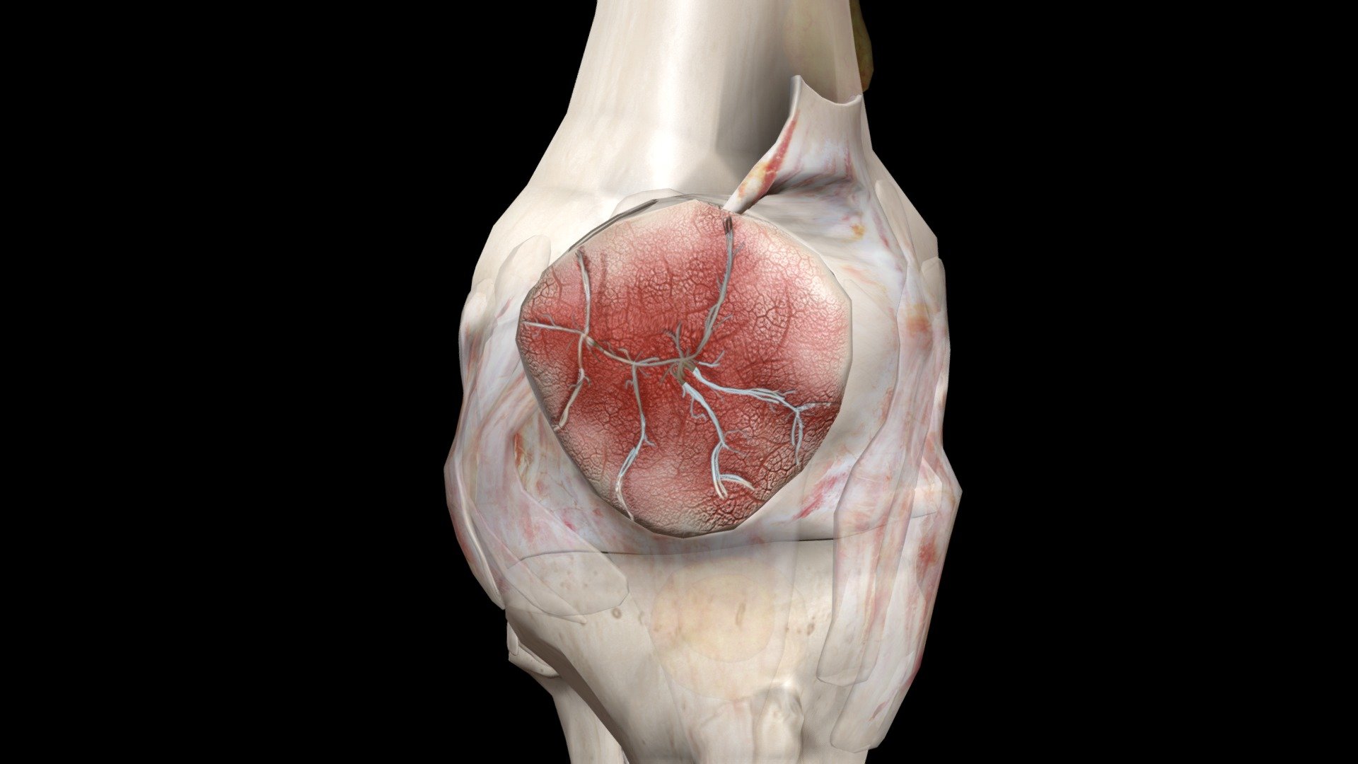Patella Fracture: Comminuted Displaced - 3D model by Connections XR ...