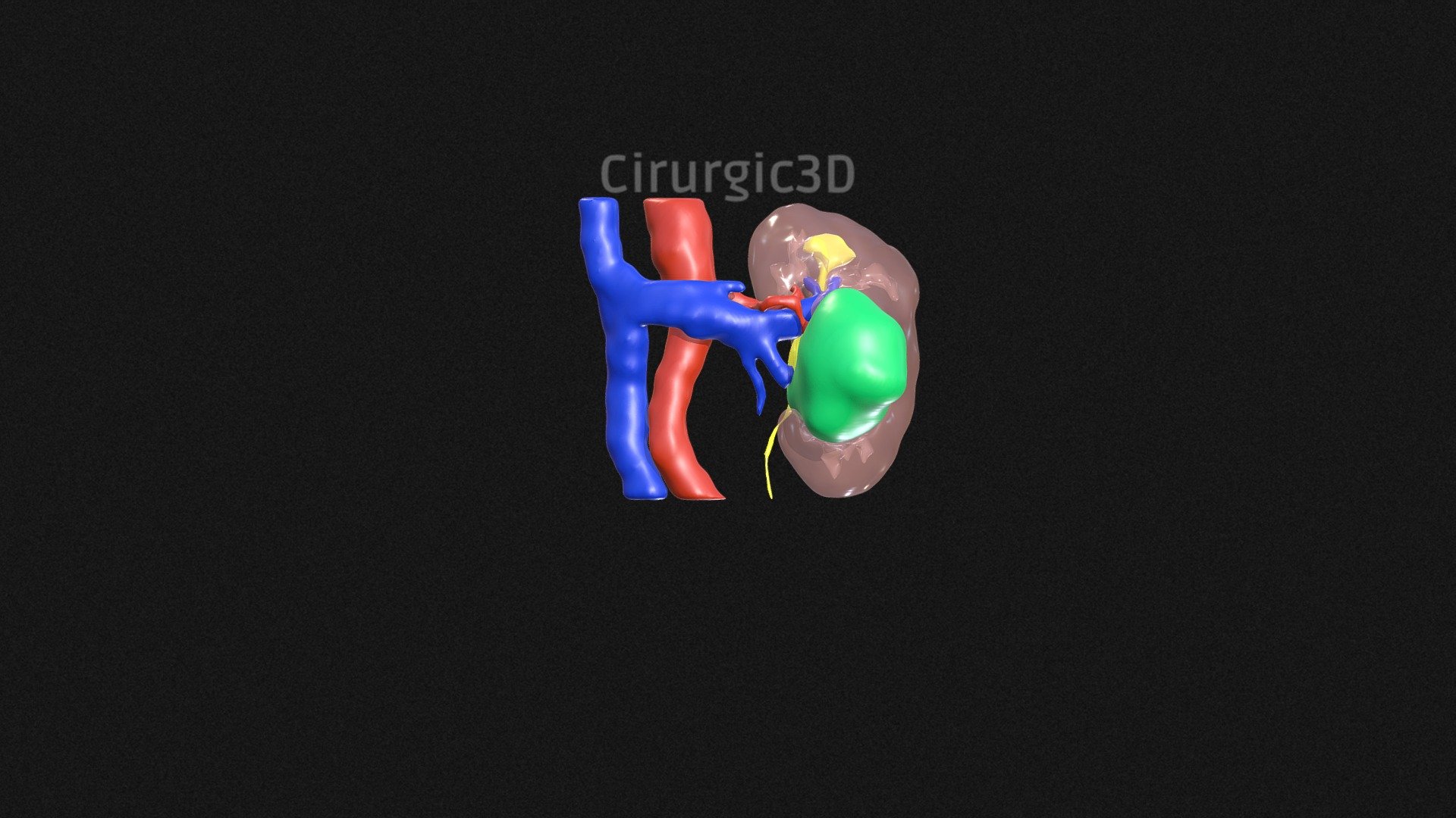 Left Kidney Tumor - 3D model by Cirurgic3D (@neorenal) [42d176f ...