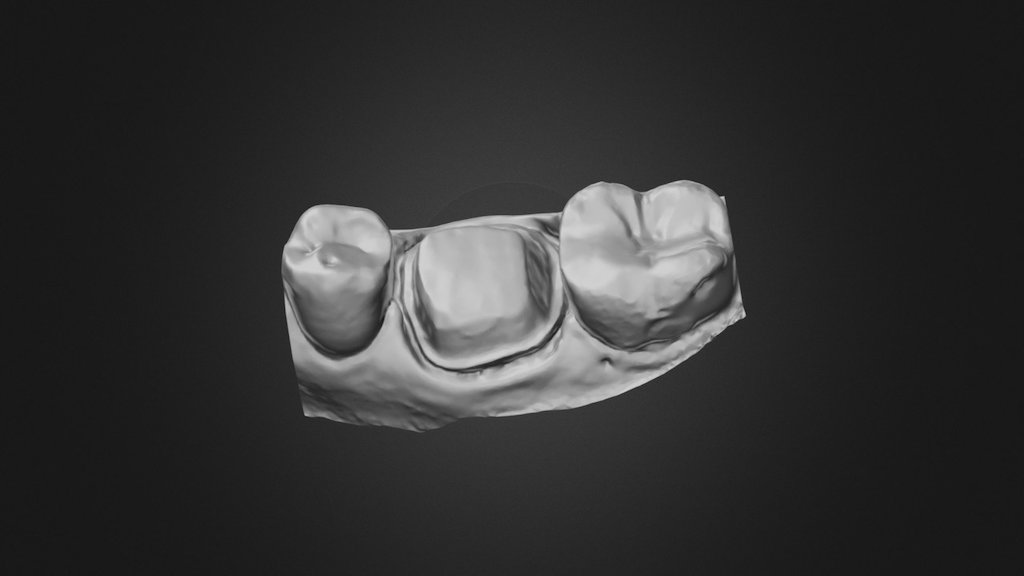 36 Emax/Celtra Duo prep - 3D model by ammster [431c671] - Sketchfab