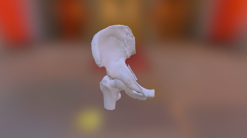 Acetabular Fracture - sku 243 - 3D model by orto3d [4321918] - Sketchfab