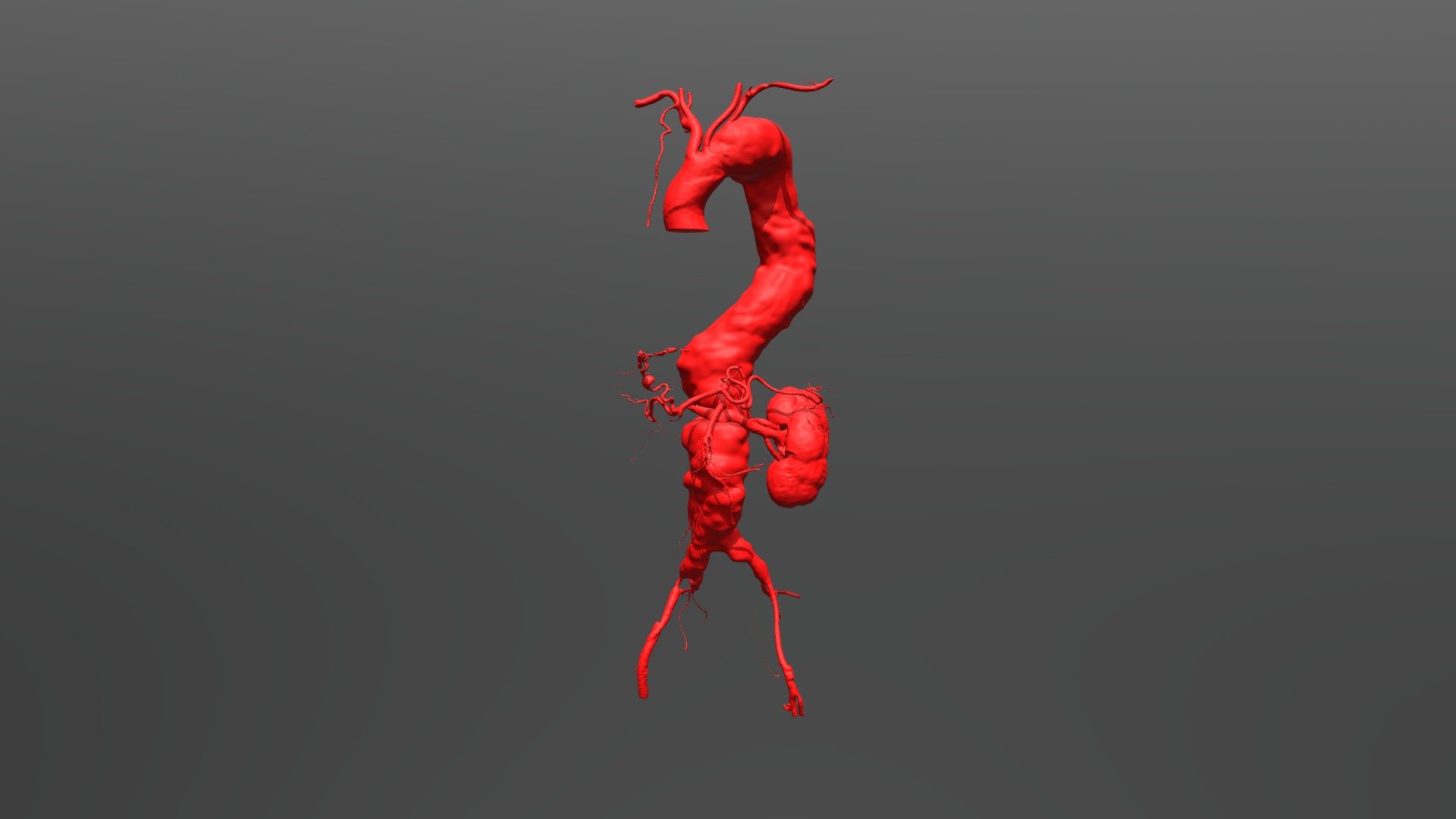 Dissecation of the abdominal aorta, Exterior - 3D model by valchanov ...