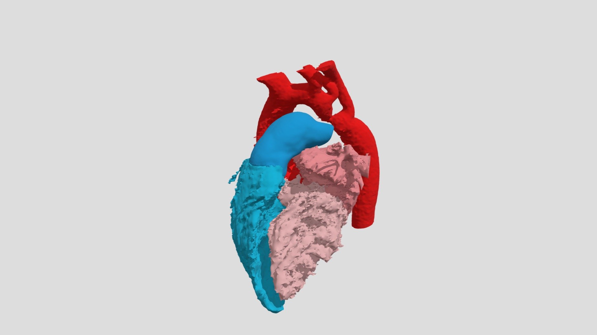 Coarctation of Aorta (S0306) - 3D model by NCHS Cardiac Advanced ...