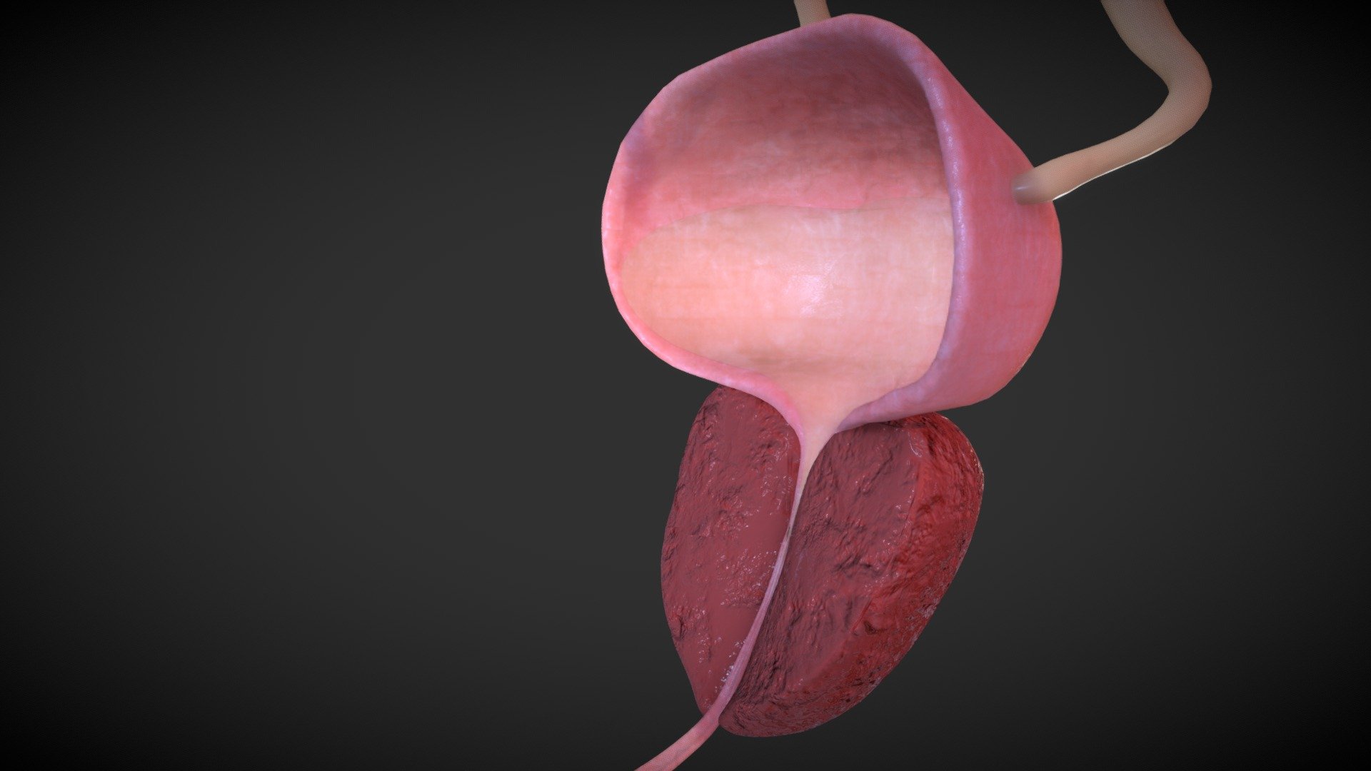 Benign prostatic hyperplasia - Buy Royalty Free 3D model by Ebers ...