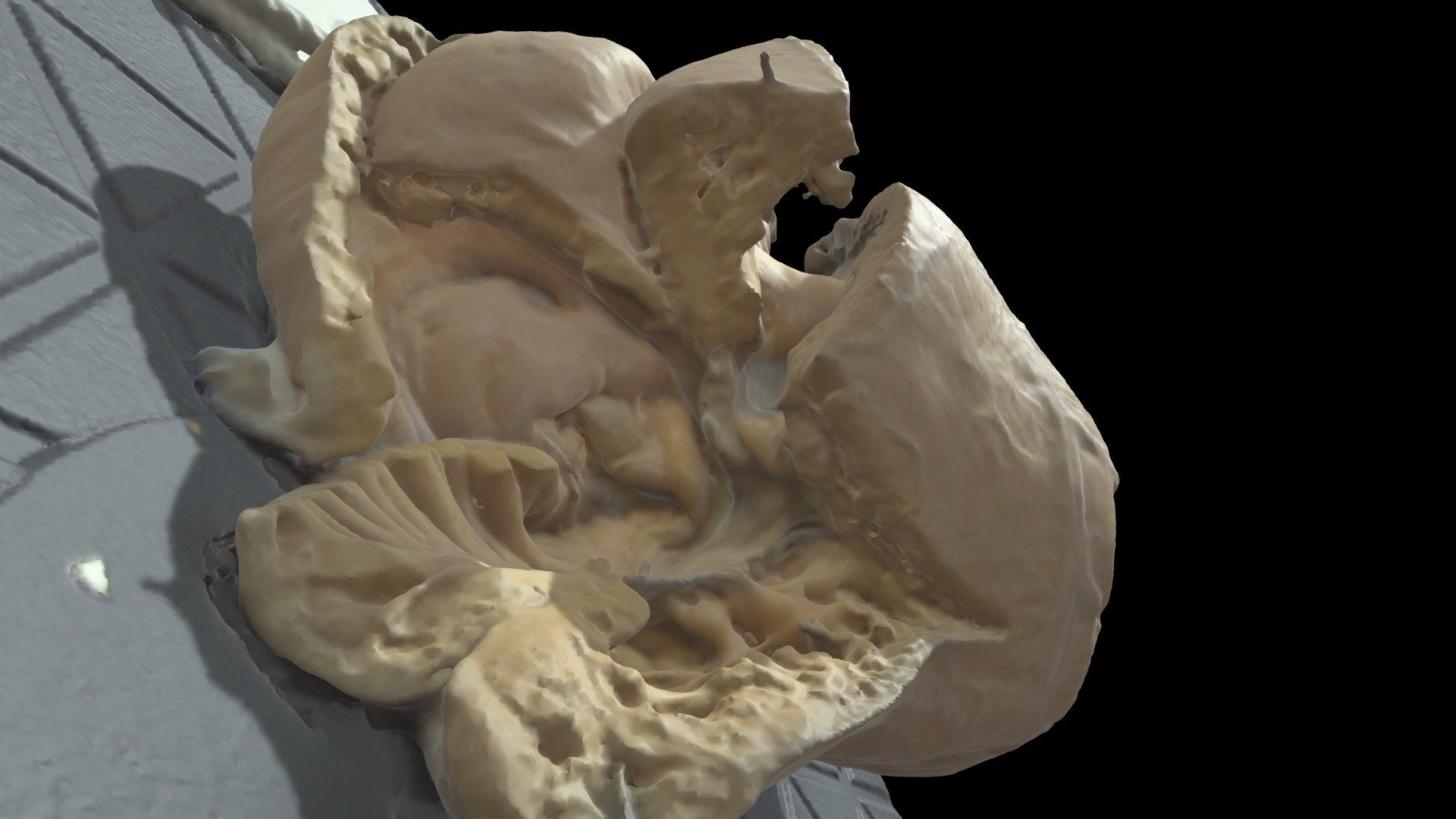 Atrioventricular septal defect ach-25 - 3D model by Rohit Loomba ...