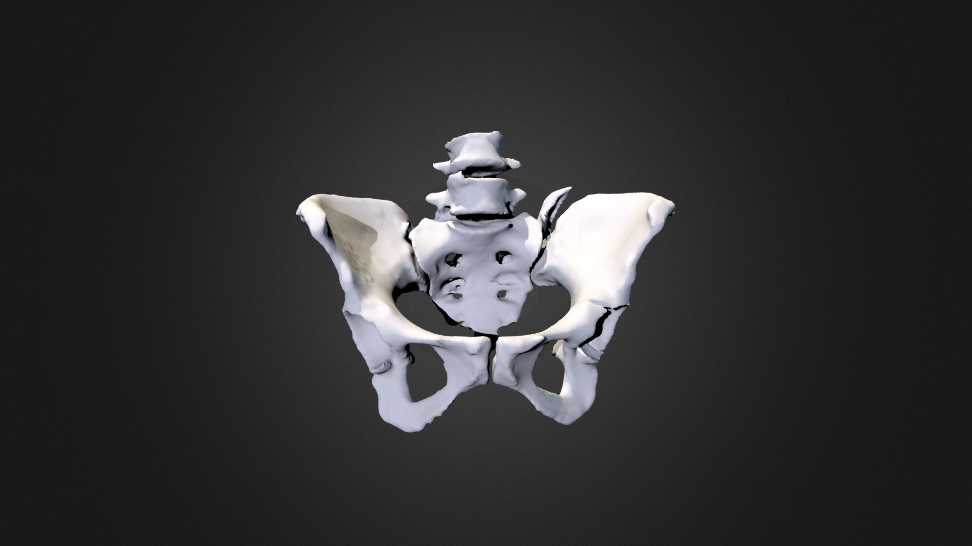 sacral and acetabular fracture | F-1603388 - 3D model by World Surgery ...