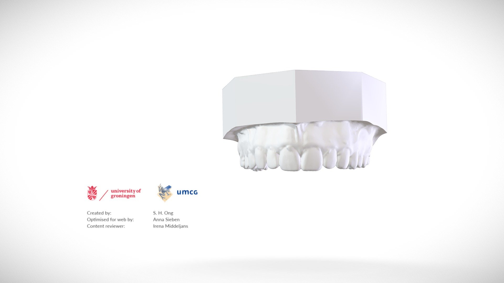 Upper jaw model following orthodontic treatment - 3D model by E ...