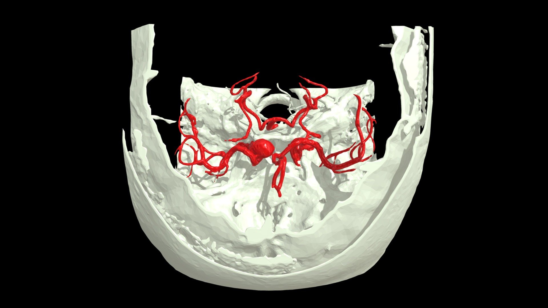 Aneurysm in Willis Polygon - 3D model by Tecdes SA (@tecdessa) [4615013 ...