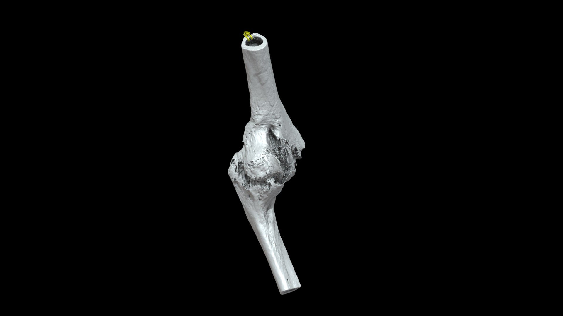 L. Elbow with Traumatic Fusion (VCU_3D_5443) - 3D model by Virtual ...