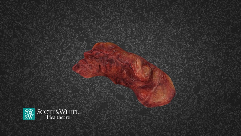 Thyroid, Colloid Adematous Goiter 104590 - 3D model by Scott & White ...