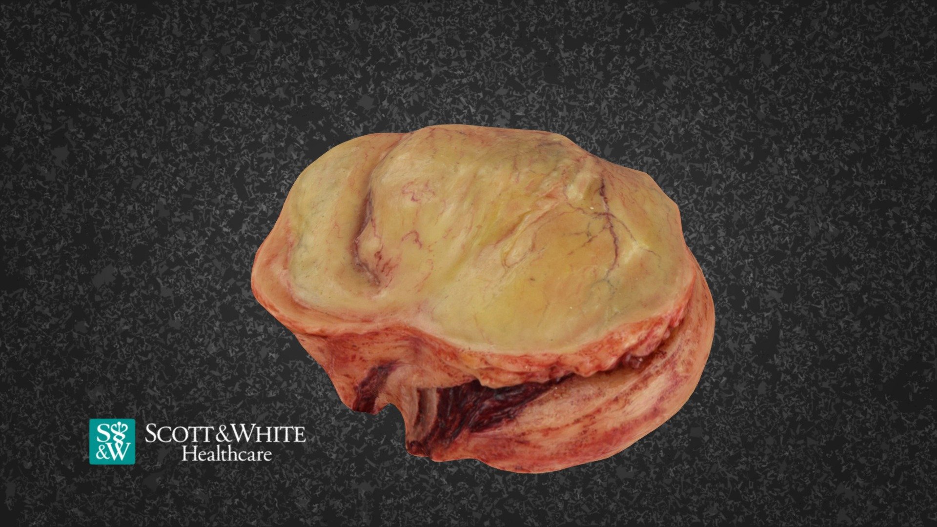 Uterus-Fibromyoma 179670 - 3D model by Scott & White Moulage Project ...