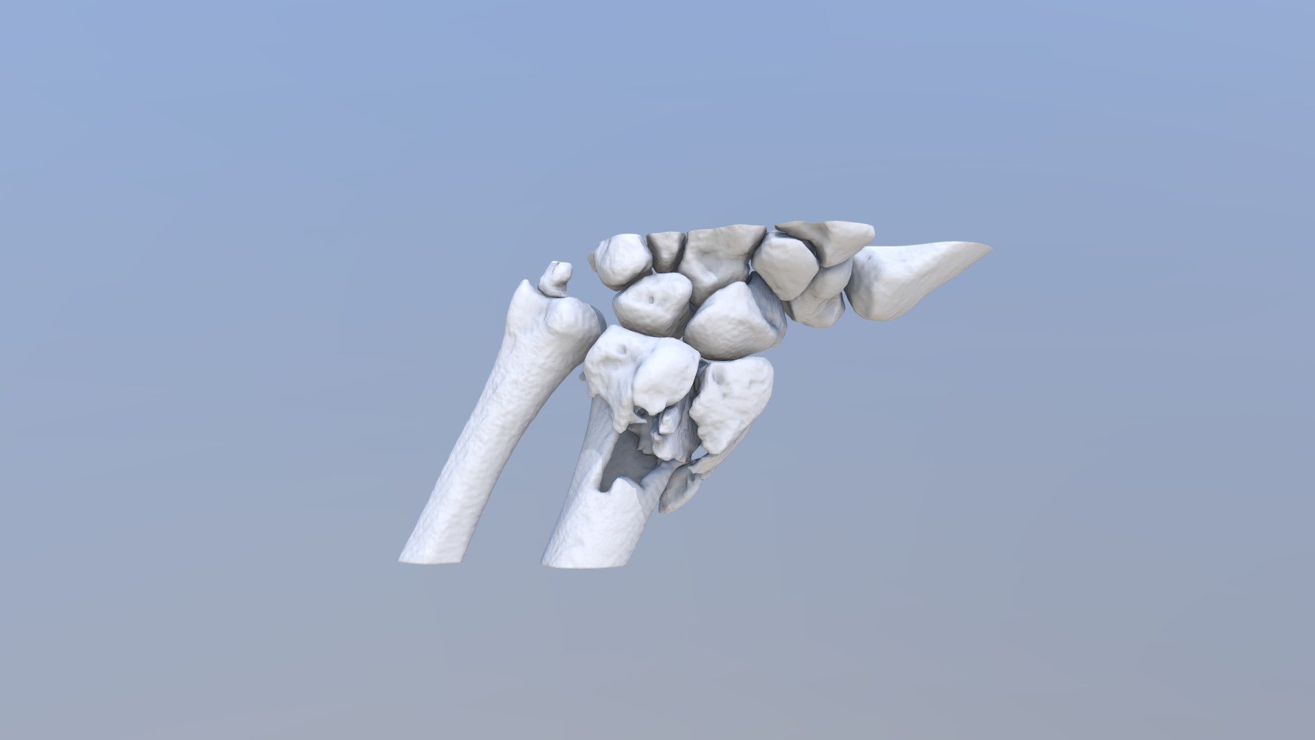 Distal radius fracture (18.07.GU) - 3D model by Innowise: VOKA Trauma ...