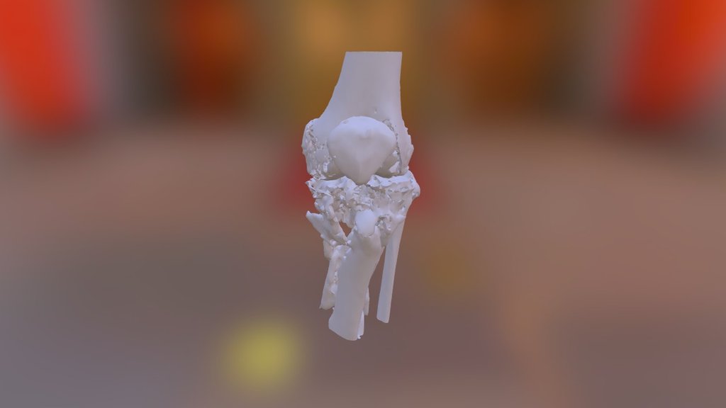 Knee - Proximal Tibia Fracture sku 038 - 3D model by orto3d [4855d75 ...