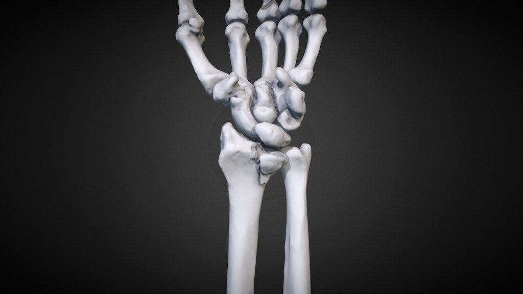 ZB-Nov17 | #1 Distal Radius (L-161999-R) - 3D model by World Surgery ...
