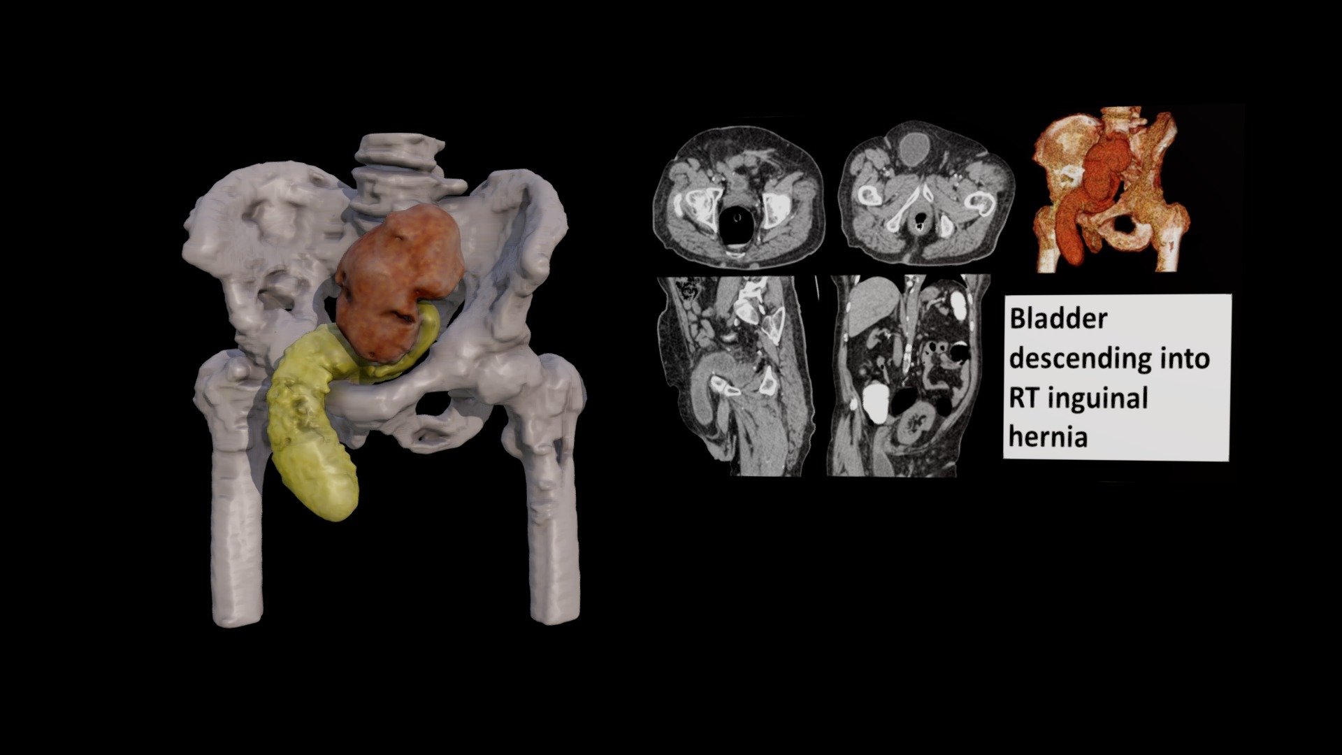 RT inguinal hernia containing the bladder - 3D model by tl0615 [48ee970 ...