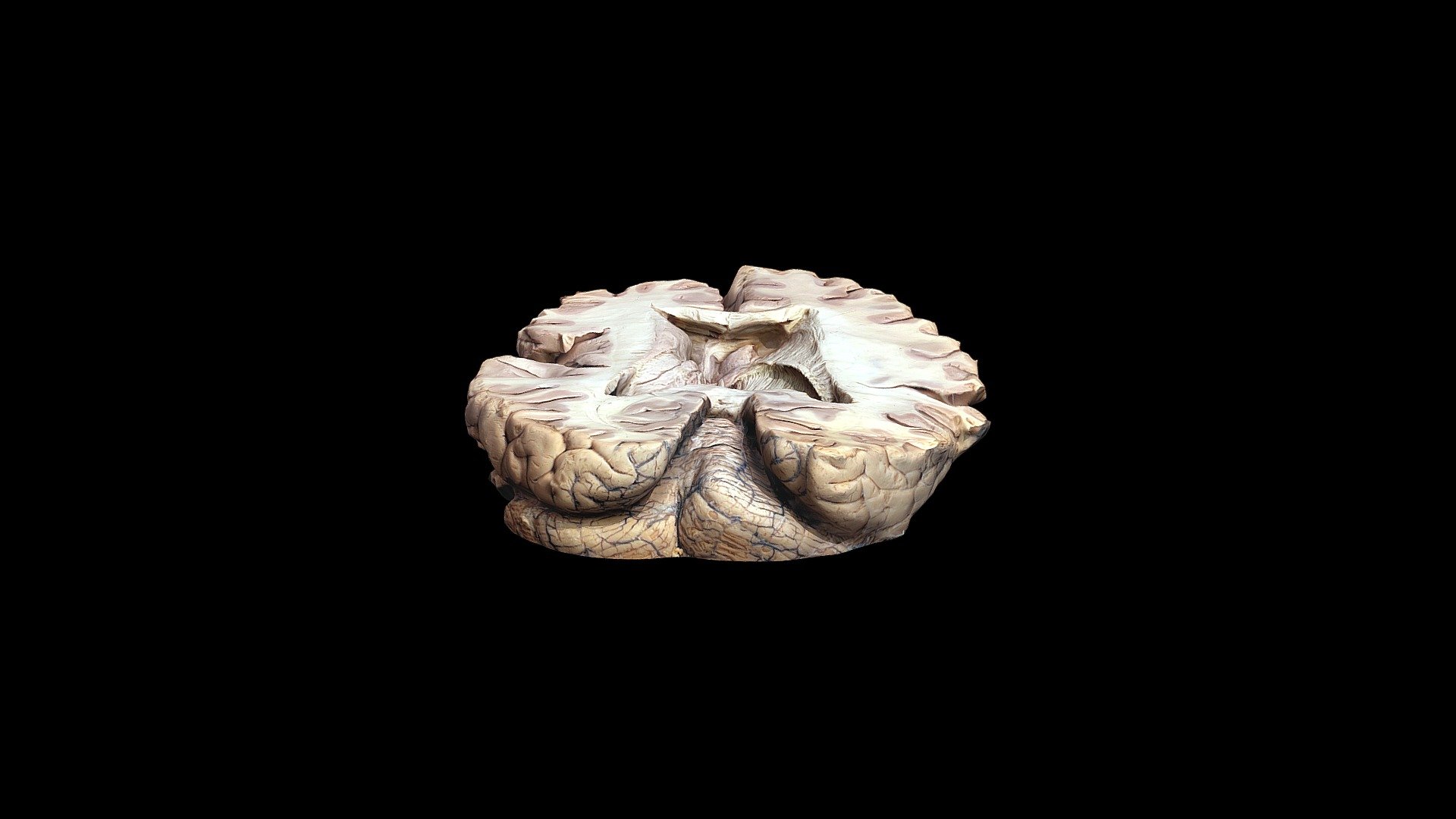 Subthalamic Nucleus (Right Sided) - 3D model by Istanbul ...