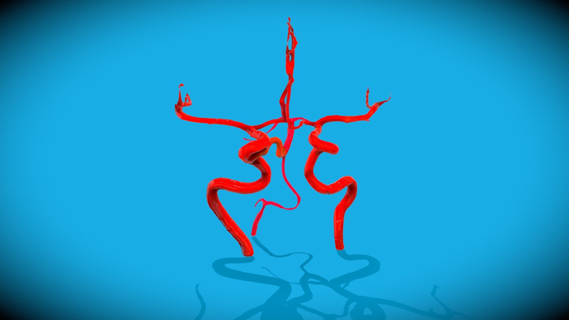 Persistent Primitive Trigeminal Artery Mri Stl Download Free 3d Model
