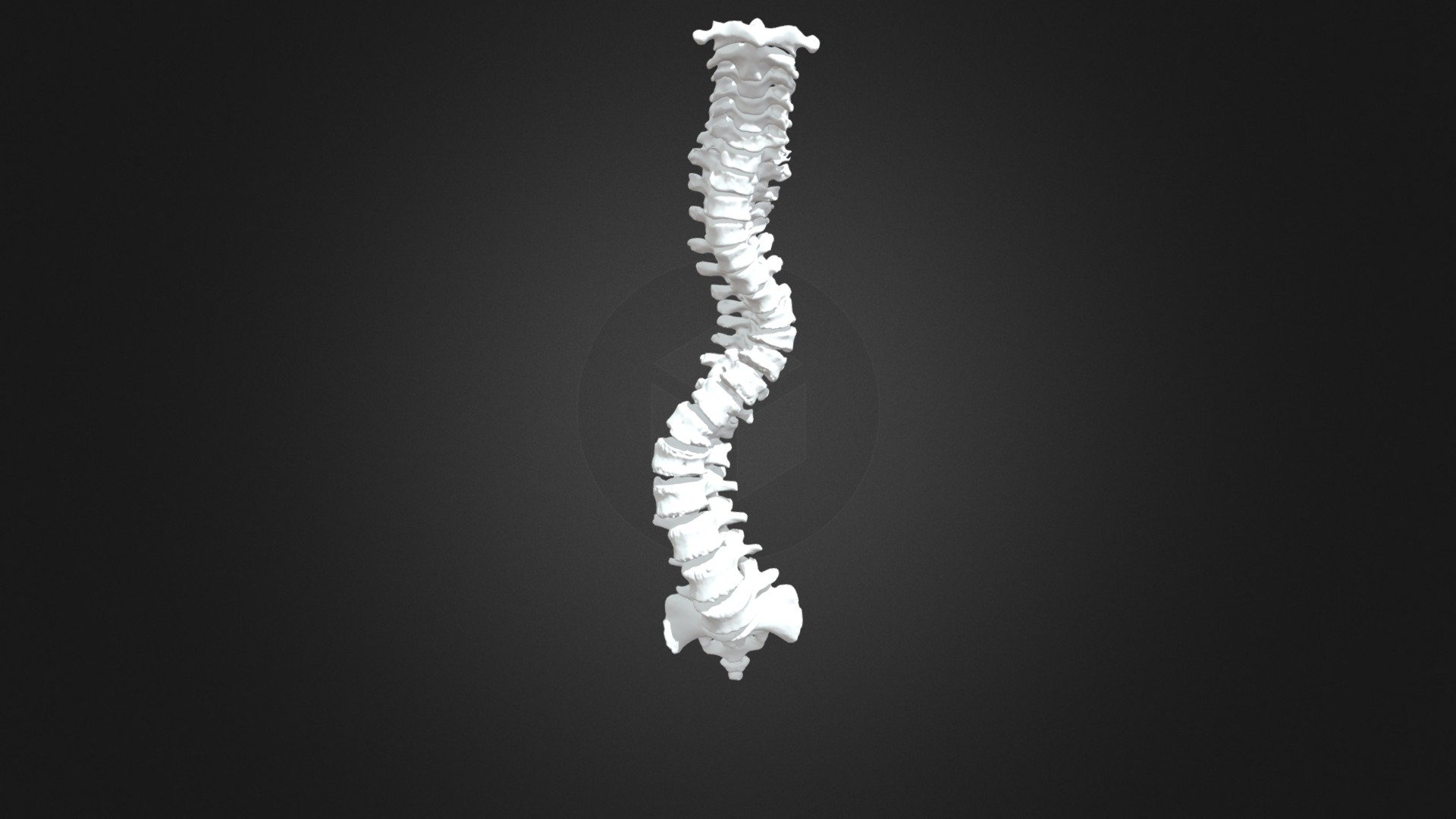 Scoliosis - 3D model by phdang [49d4331] - Sketchfab