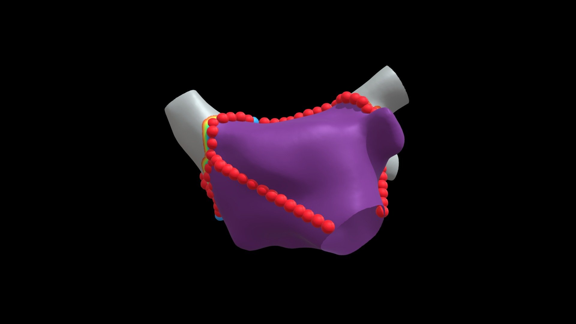Common Ablation Lines - annotated - 3D model by drj (@drjameswinter ...