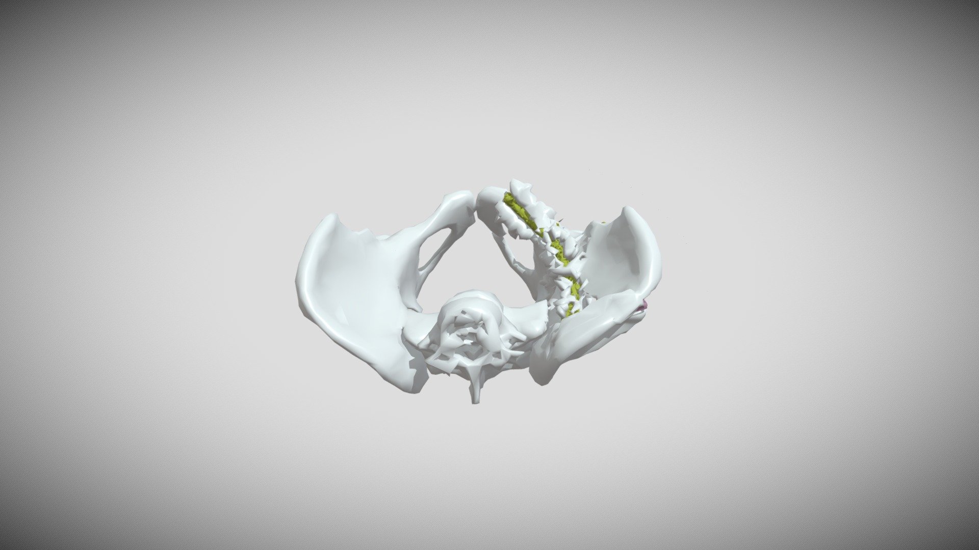 PELVIC FRACTURE & HARDWARE - Download Free 3D model by mhight [4a22bc0 ...