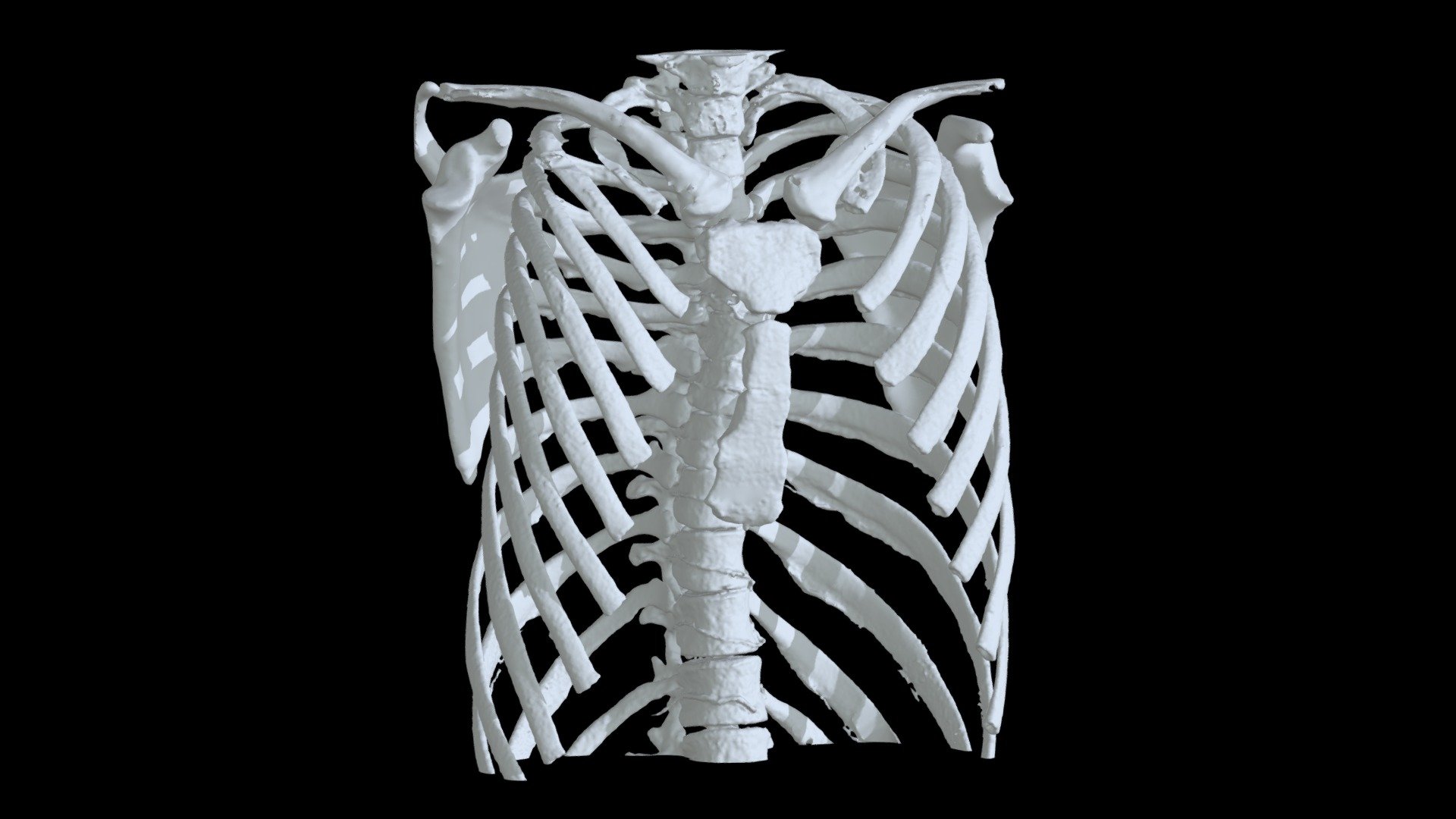 Pectus Excavatum - Escoliosis - 3D model by quequen [4a7862b] - Sketchfab