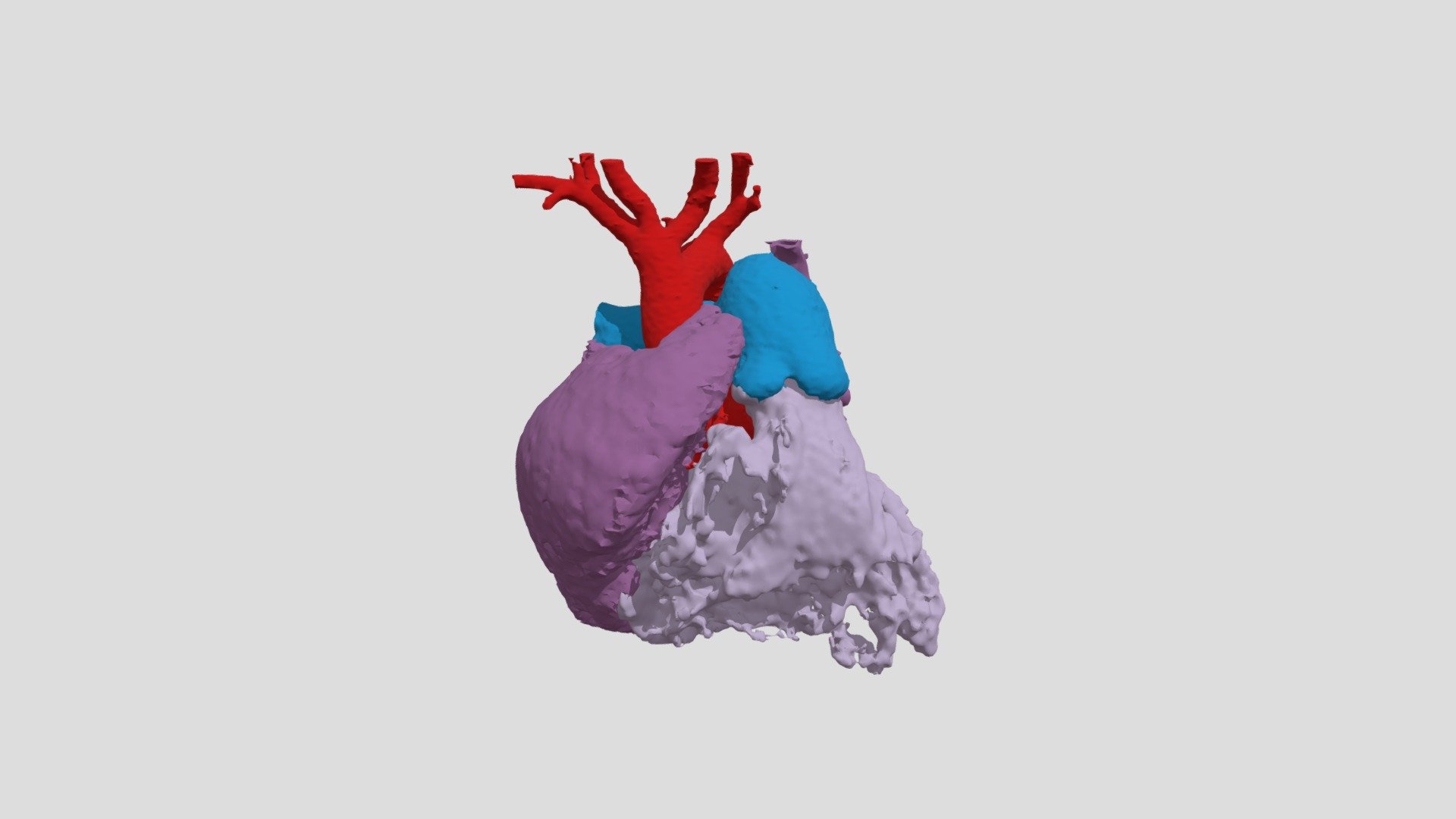Conoventricular Outlet VSD, LSVC (S0329) - 3D model by NCHS Cardiac ...