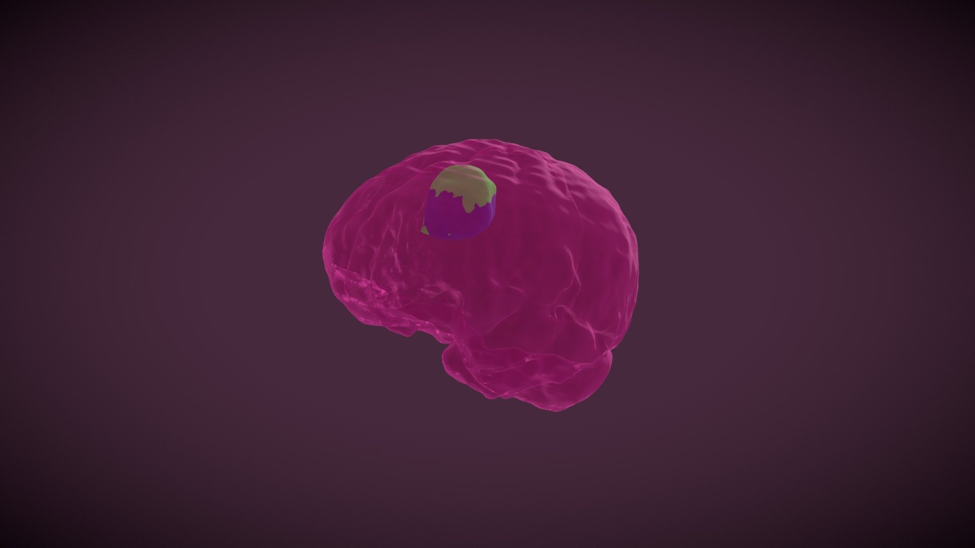 Brain Tumor 1 and 2 - Download Free 3D model by CaitlynnH [4c6d7d5 ...