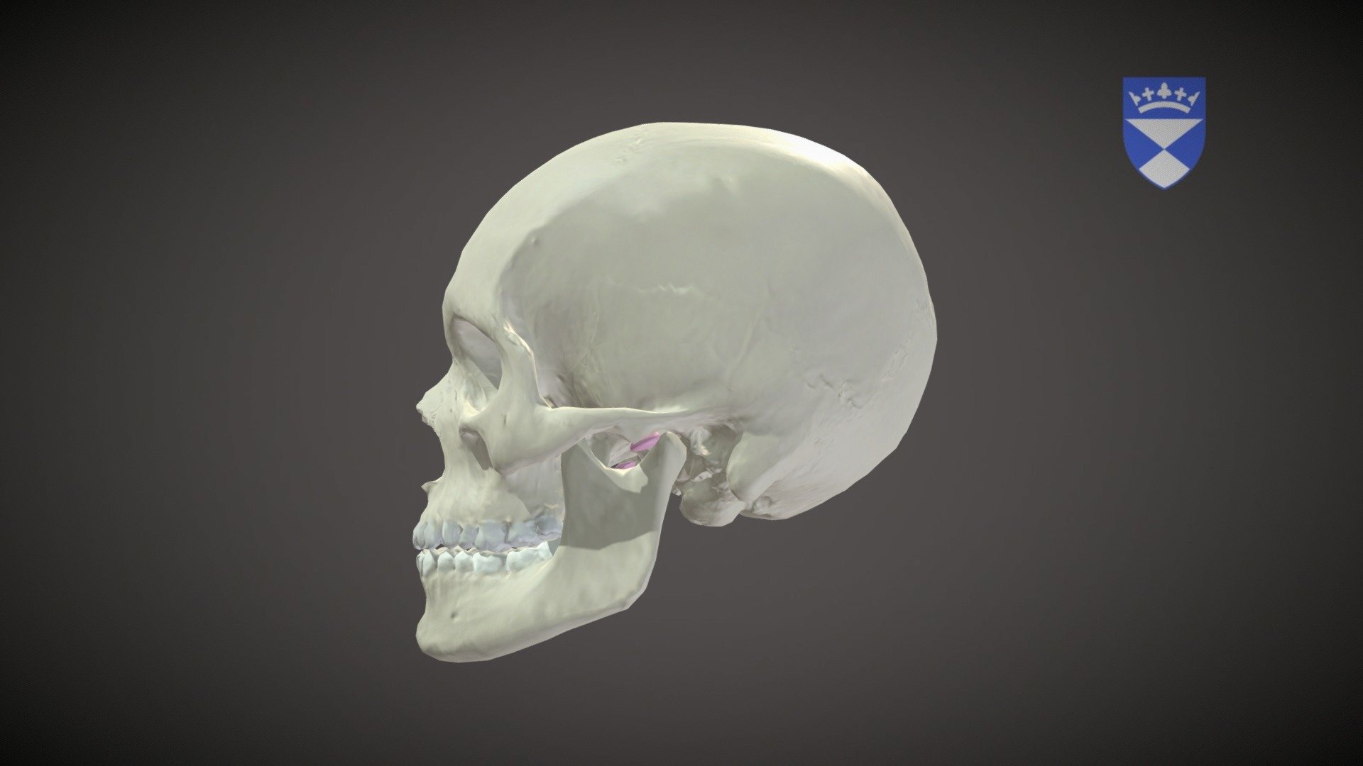Disc displacement without reduction. - 3D model by University of Dundee ...