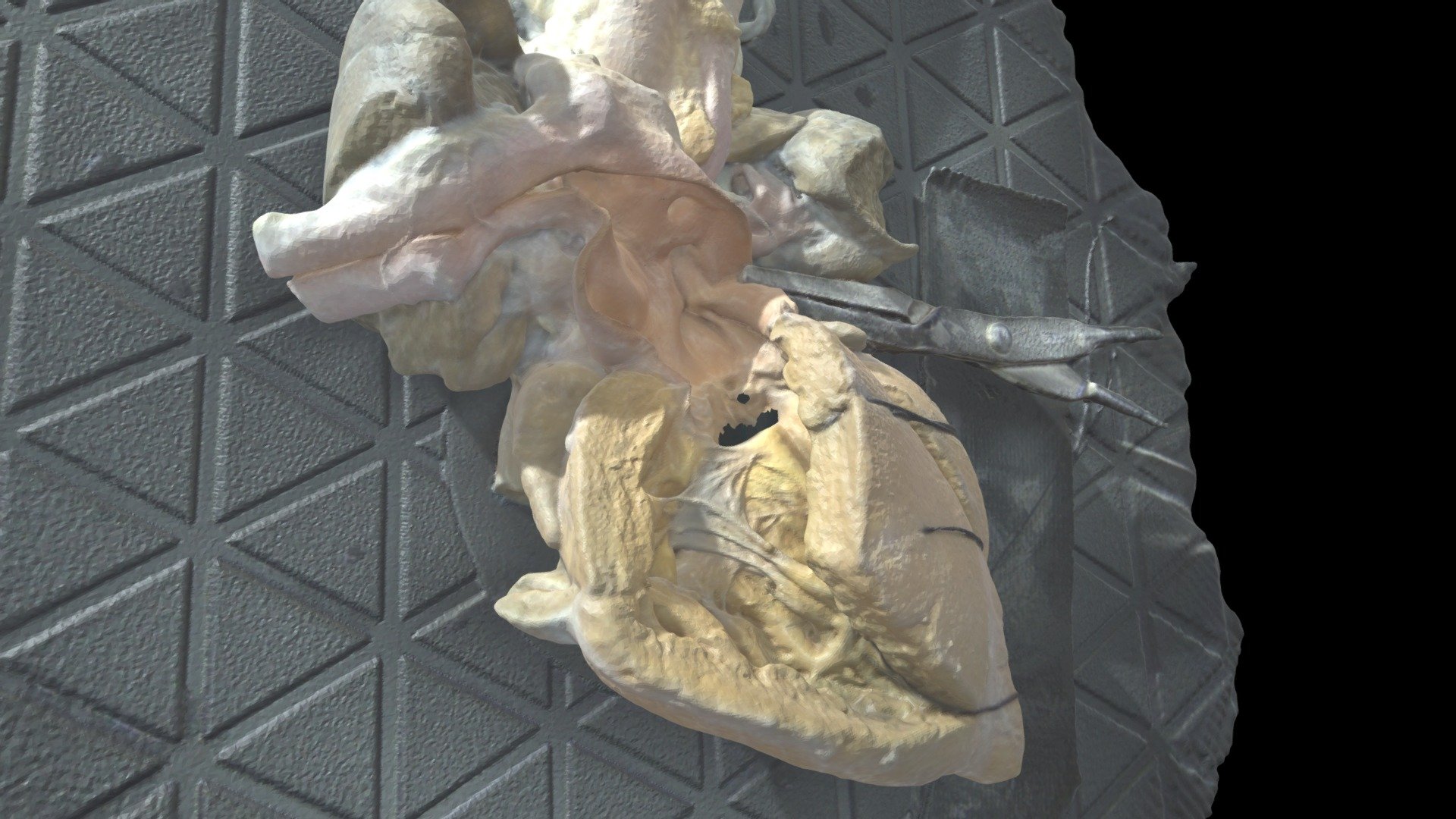 Common arterial trunk ach-9 - 3D model by Rohit Loomba (@loomba.rohit ...