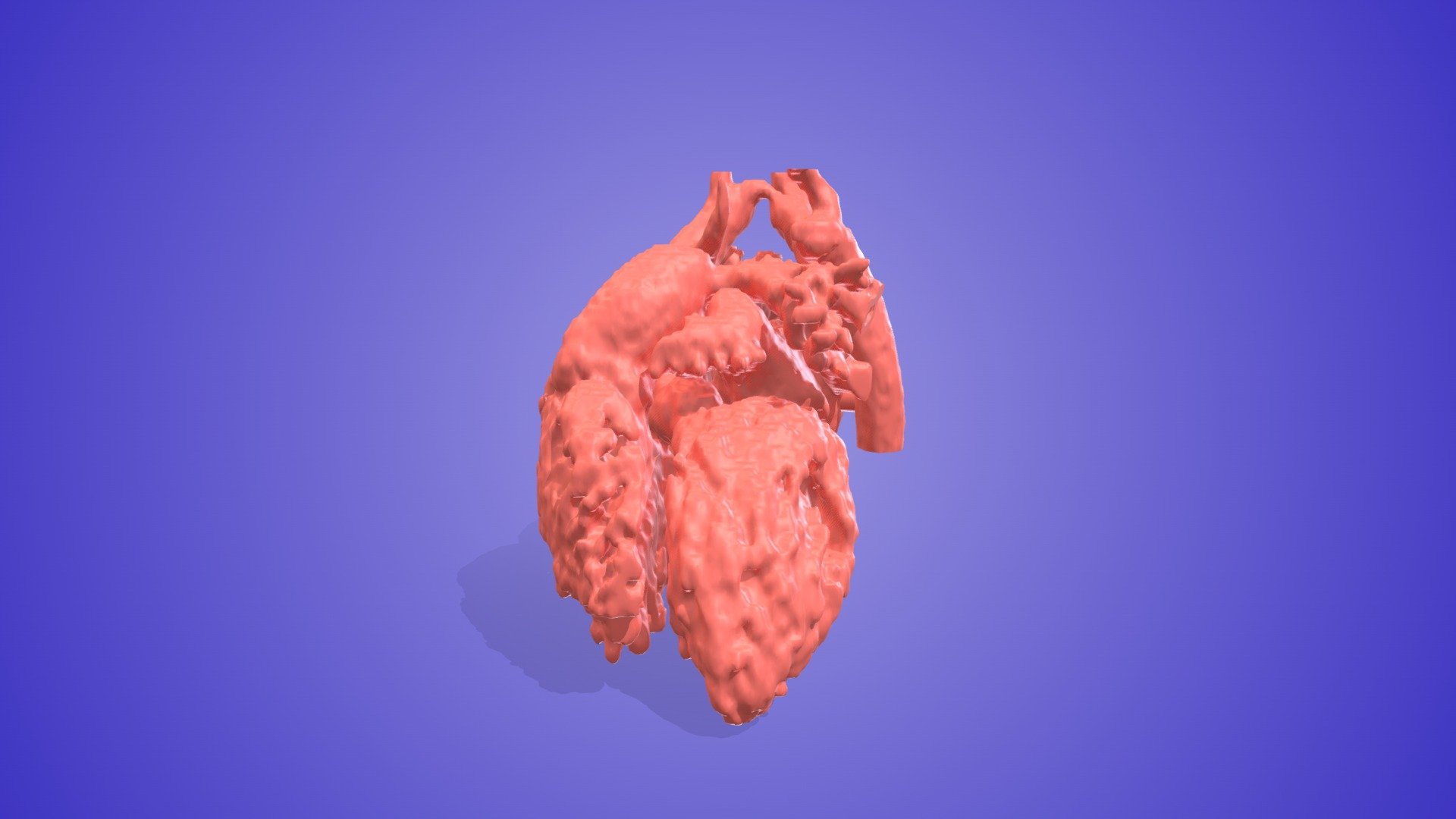 Coarctation of the Aorta - Download Free 3D model by 3D Heart Project ...