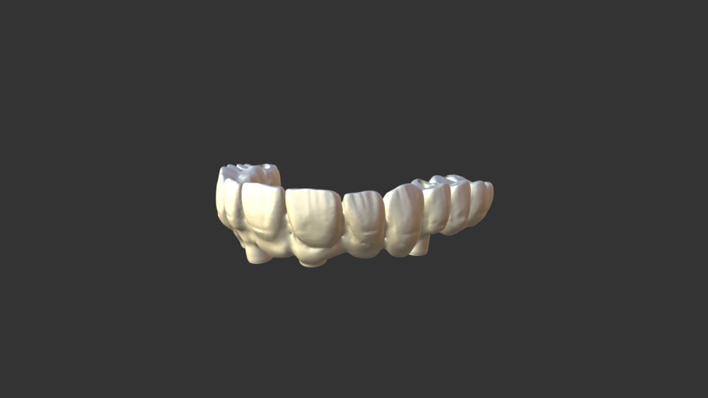 Full Contour Bridge On Ti-bases - 3D model by Arum3D solutions ...