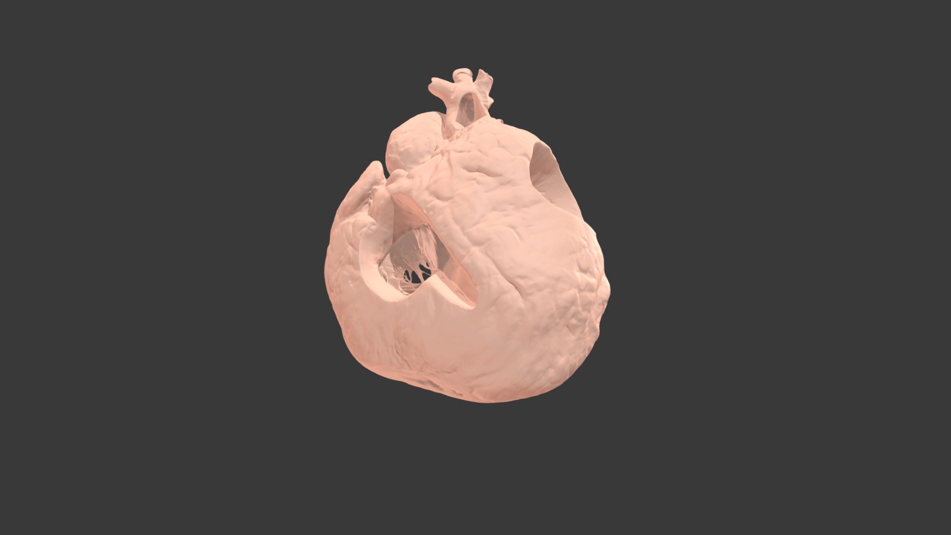 LTGA #1 - LTGA {S,L,L} with VSD, PVO - 3D model by heartmodels [4e918f0 ...