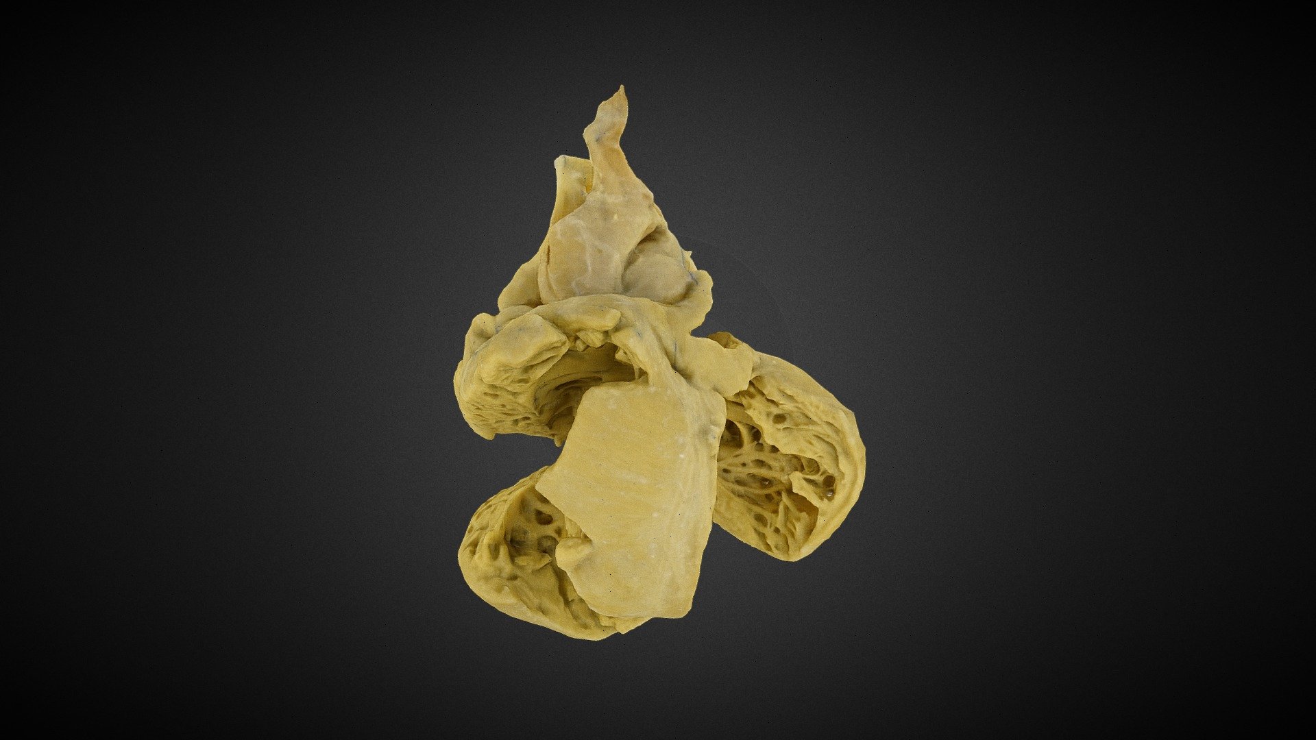 45: Heterotaxy (left isomerism) - 3D model by CHOP Cardiac Specimens ...