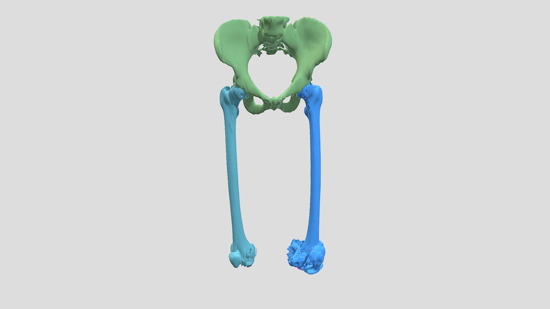 Femur and Implant Segmentations - Download Free 3D model by katspencer ...