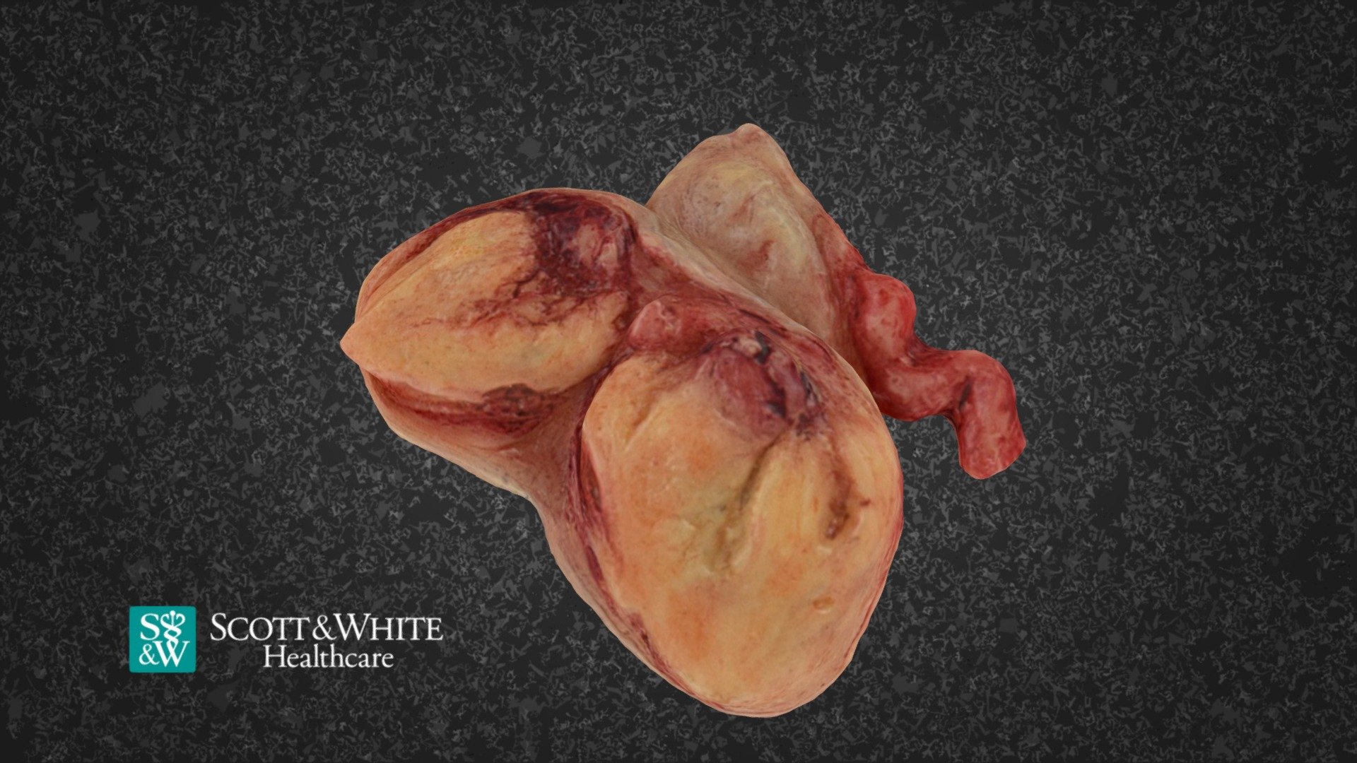Uterine Structure Atrophy 282835 - 3D model by Scott & White Moulage ...