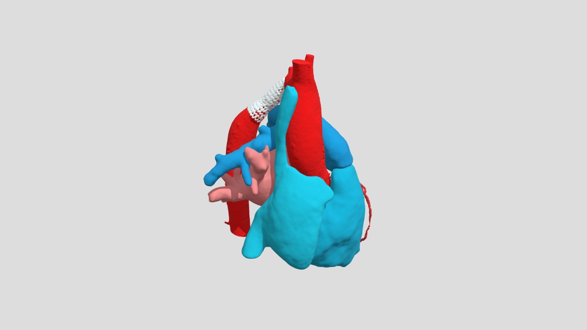 Coarctation of Aorta with Stent (S0305) - 3D model by NCHS Cardiac ...